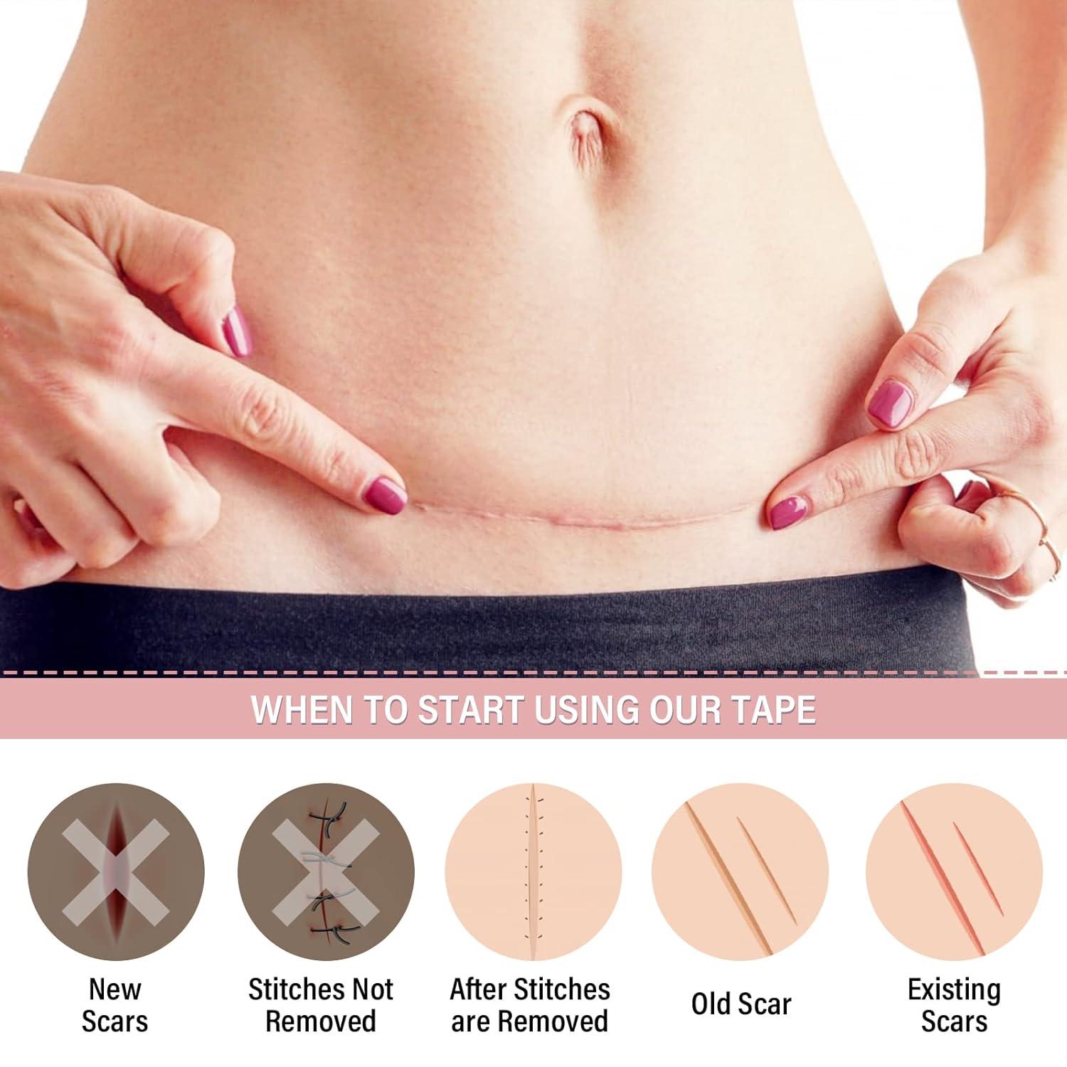 Silicon Scar Sheets (4cm*3m) Nude Color Silicone tape Scar Tape Silicon Scar Tape