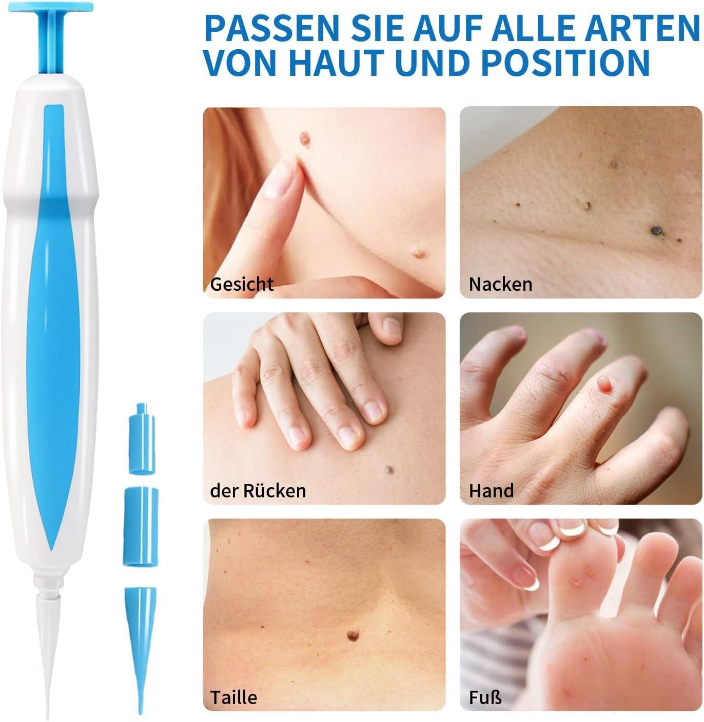 Fast & Safe Wart & Skin Tag Remover Kit | Painless 2-in-1 Solution for ...