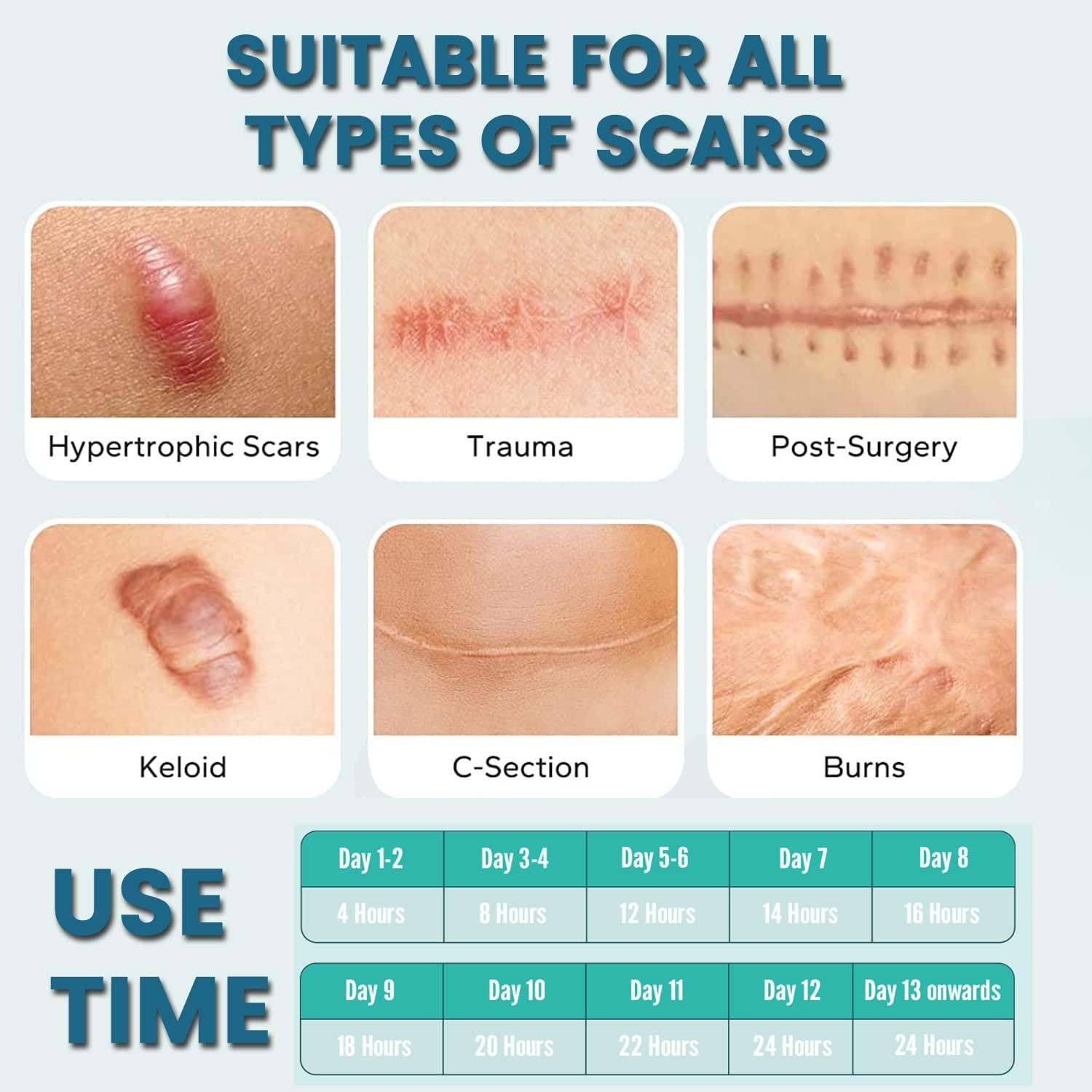 Medical Grade Silicone Scar Sheets (2 Rolls) - Acne, Burn, C-Section ...