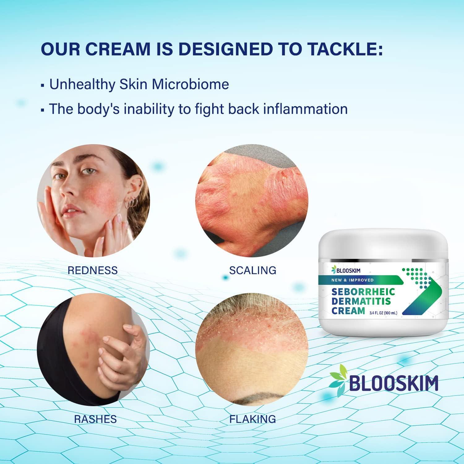 Seborrheic Dermatitis Cream - Fast-Acting Treatment for Face, Scalp ...