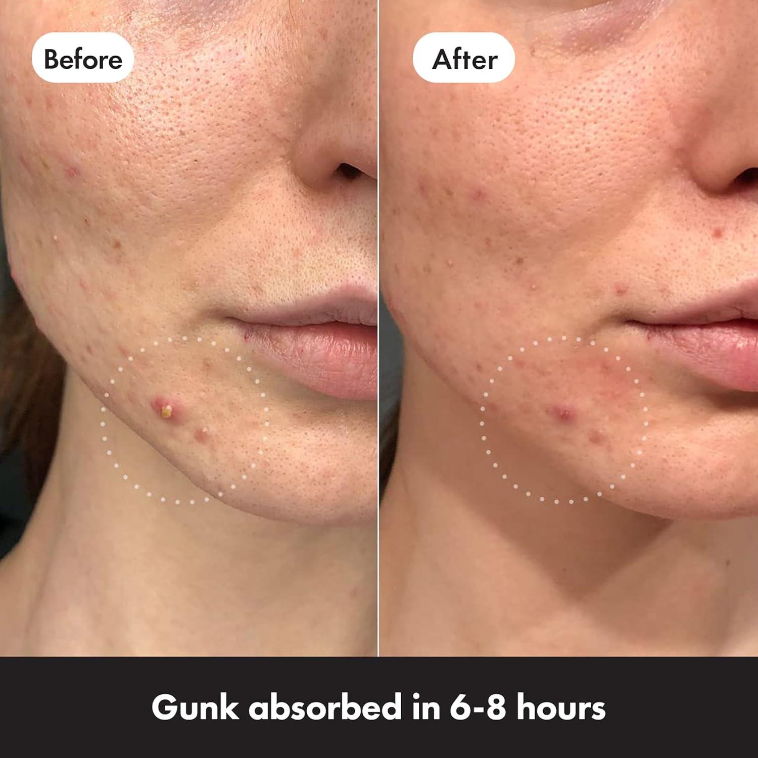 Mighty Patch Original Spot Patches by Hero Cosmetics Day & Night Time ...