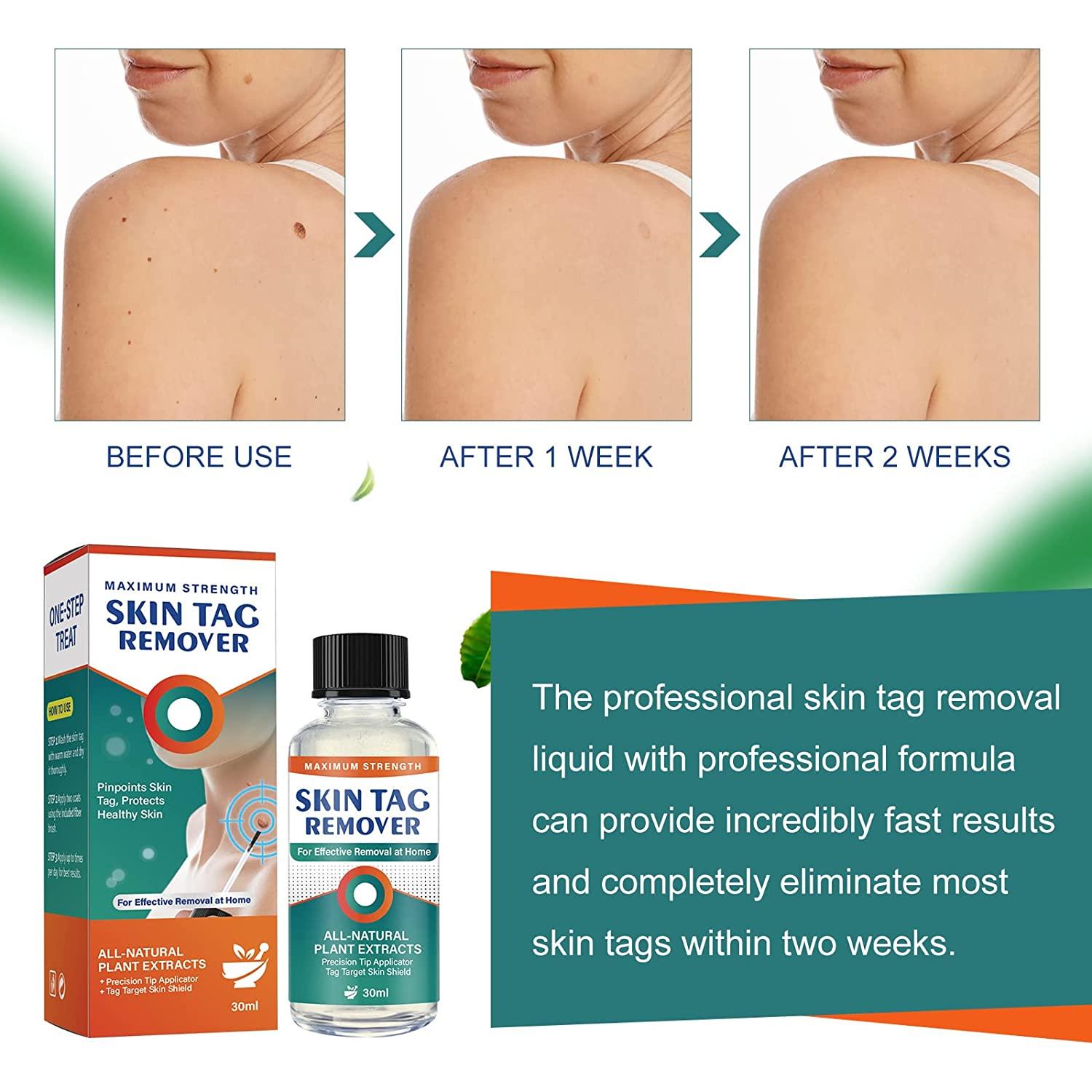 Skin Tag & Mole Remover | Quick & Effective Results | Natural Extract ...