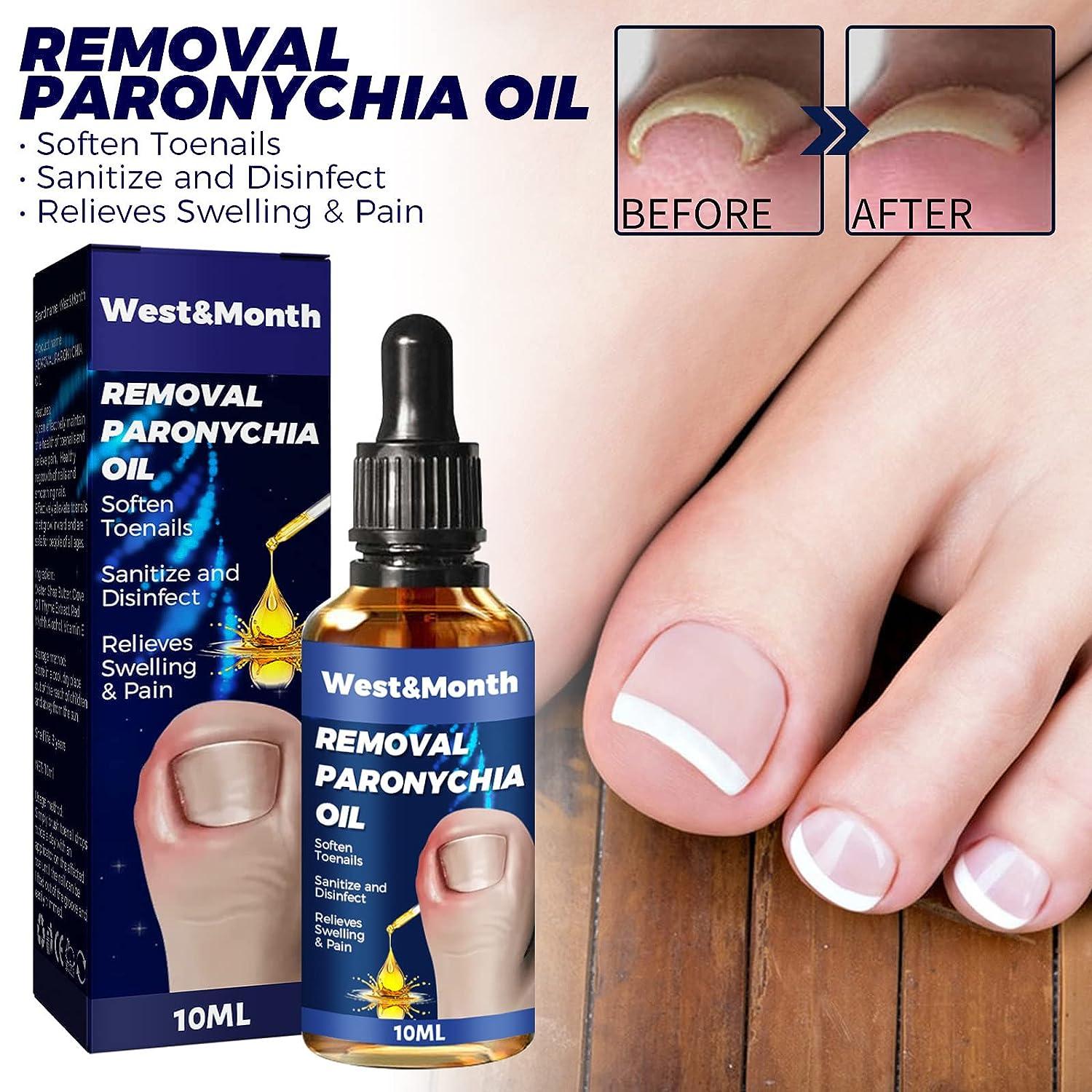 Paronychia Oil for Ingrown Toenail Treatment - Nail Renewal Liquid for ...