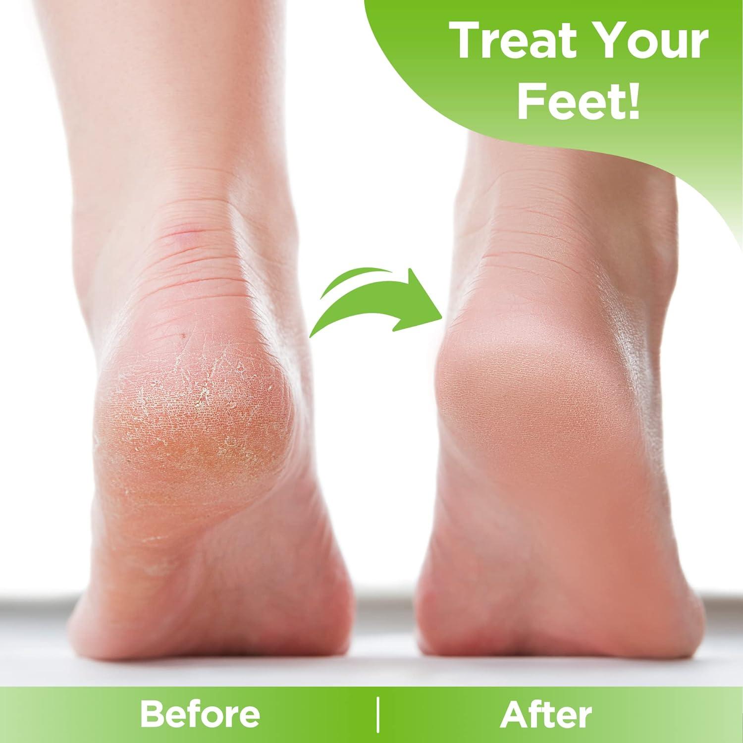 Tea Tree Foot Soak Salts for Foot Recovery - Epsom Salt Bath Soak for ...