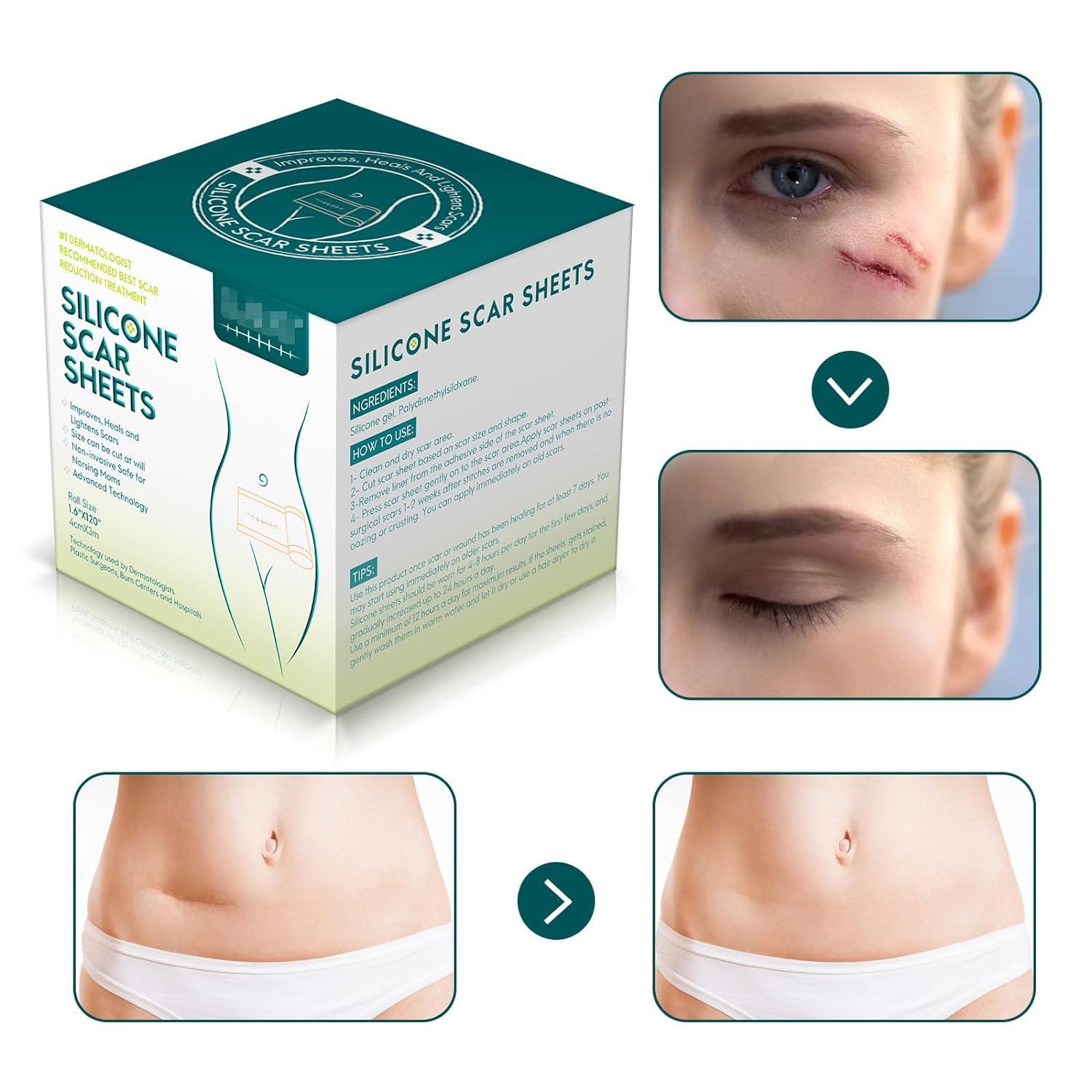 Silicone Scar Patch Roll - Professional Scar Removal Tape for Surgery ...