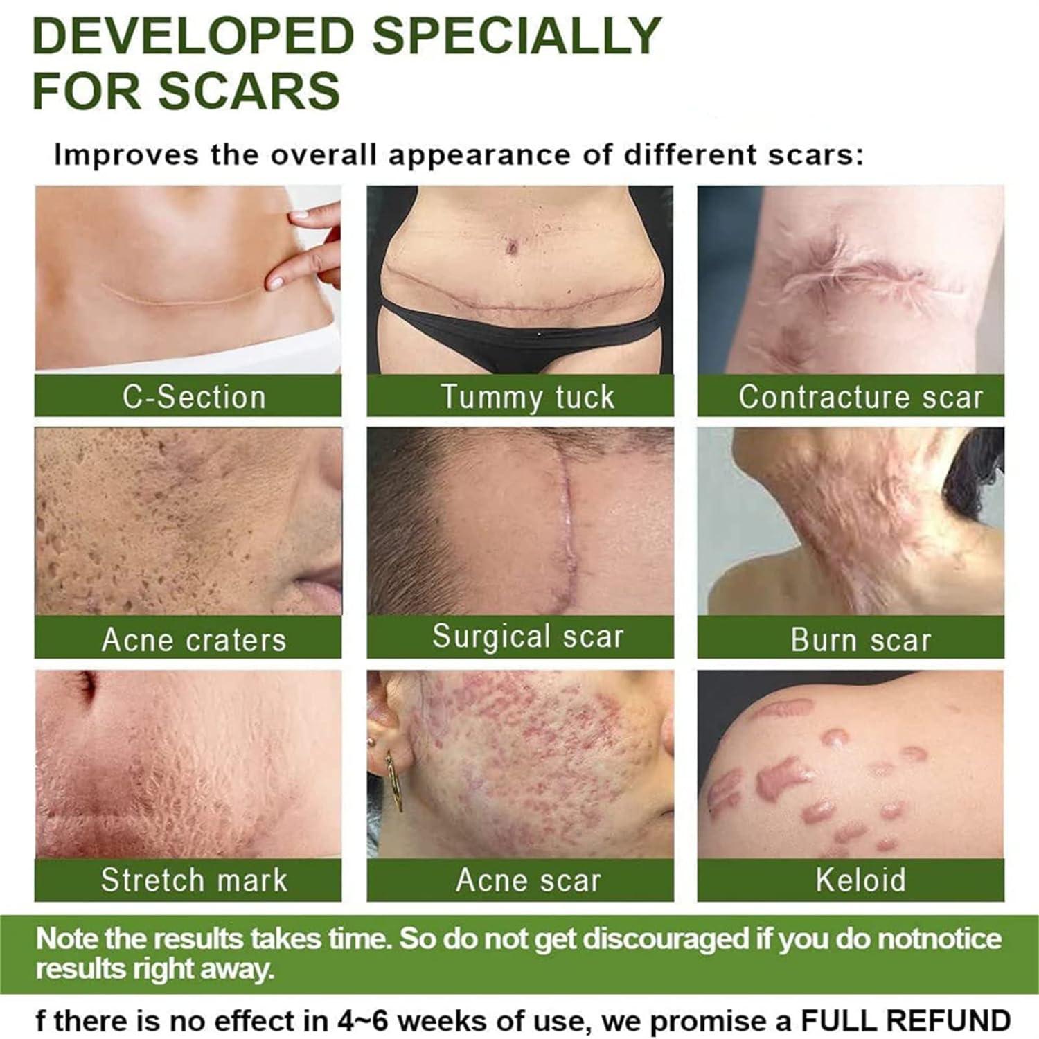 Goopgen Advanced Medical Grade Scar Repair Serum - Scar Treatment for ...