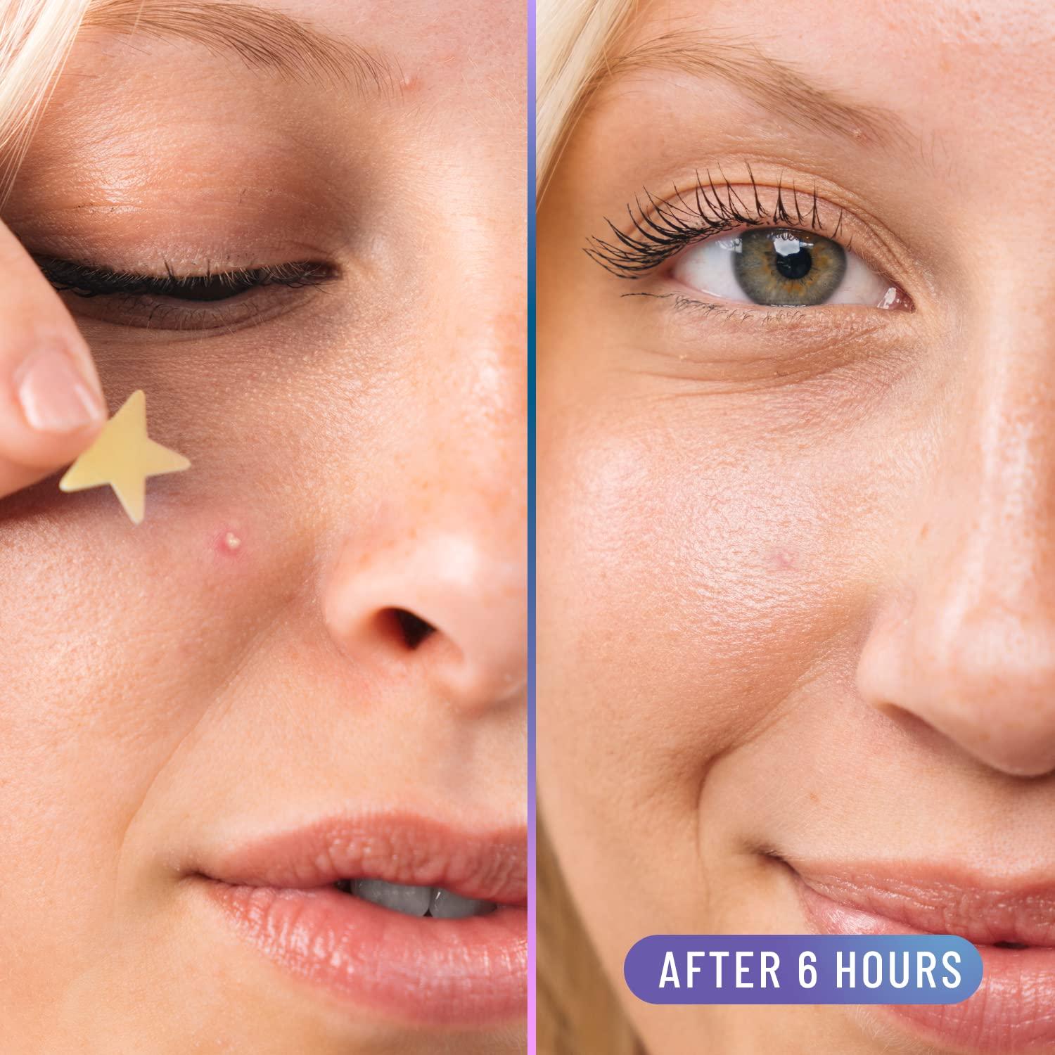 KEYCONCEPTS Star Pimple Patches (100 Pack) - Hydrocolloid Pimple ...