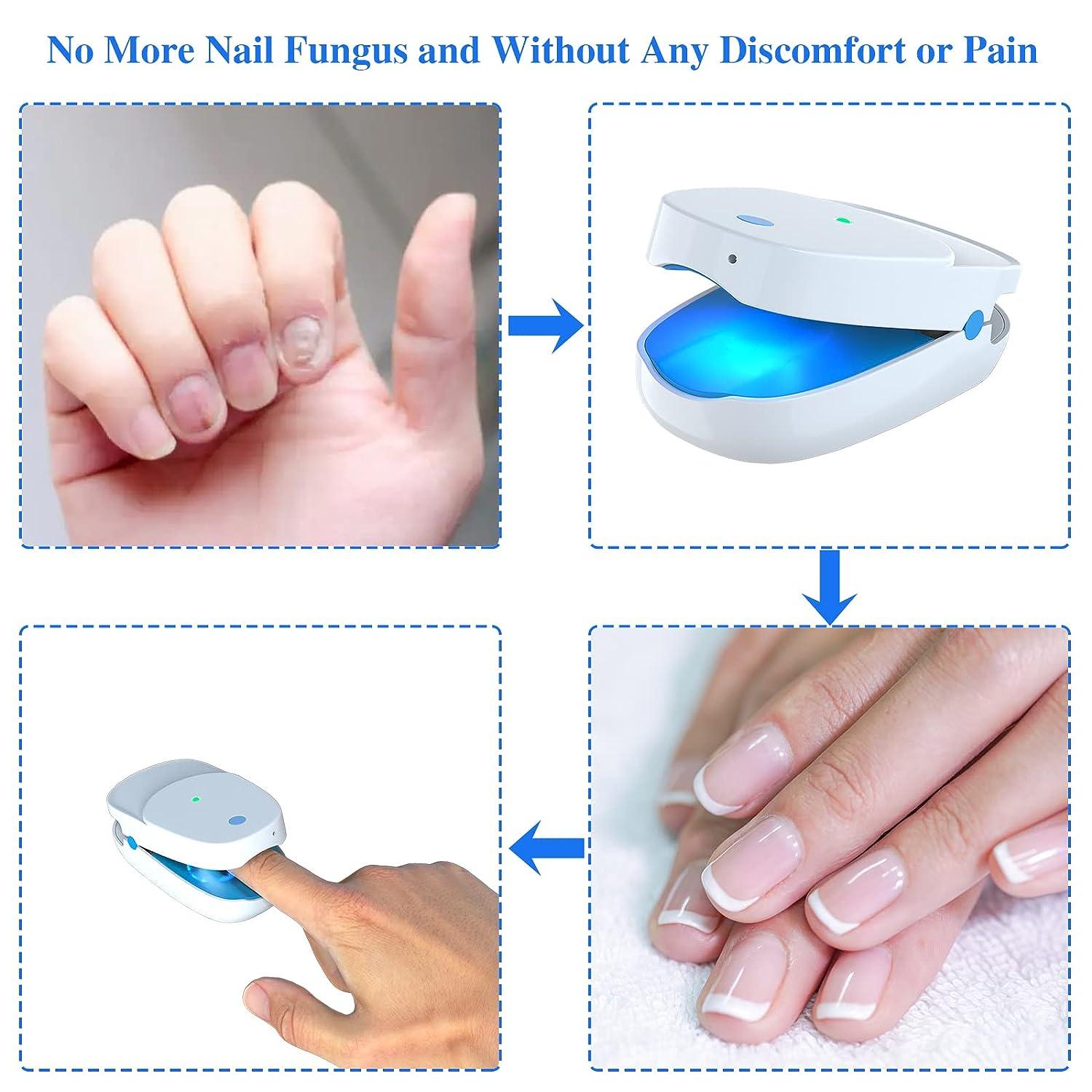 Effective Toenail Fungus Laser Remover Device for Onychomycosis ...