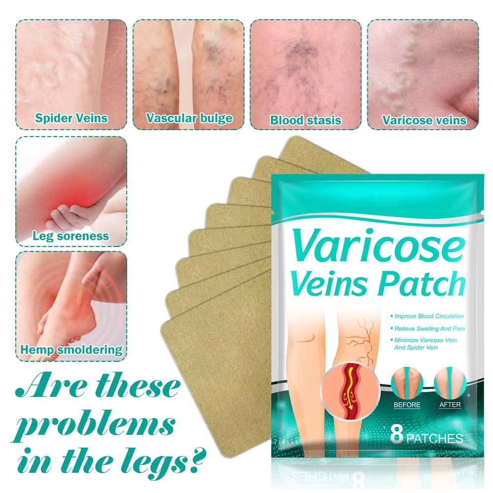 Fengyang 16Pcs Varicose Veins Treatment Patch Set for Legs - Spider ...