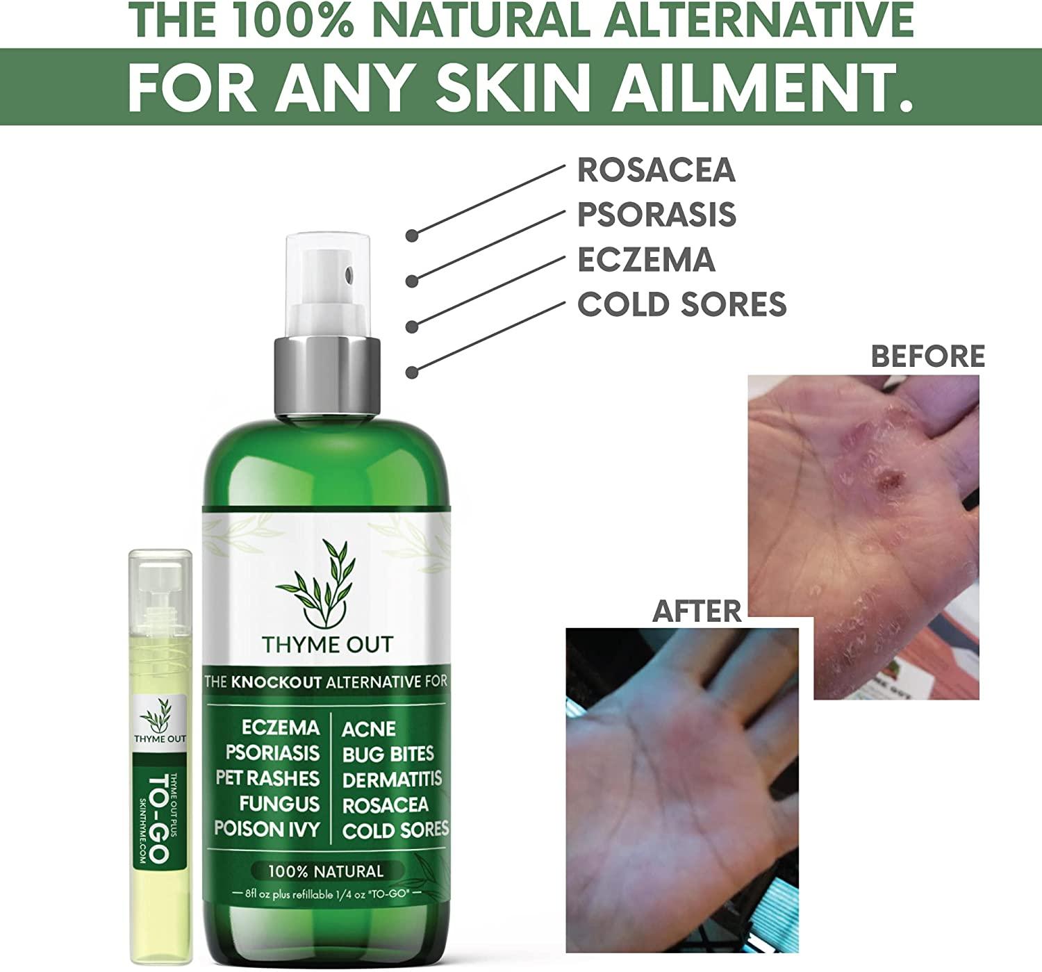 Thyme Out Natural Skin Treatment for Eczema, Psoriasis, Acne ...