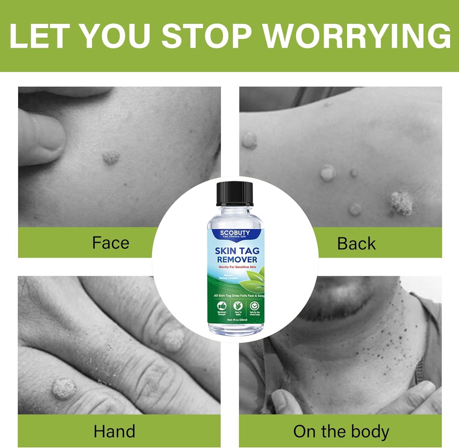 Skin Tag Removal Remover Kit Wart and Mole Remover Verruca Treatment ...