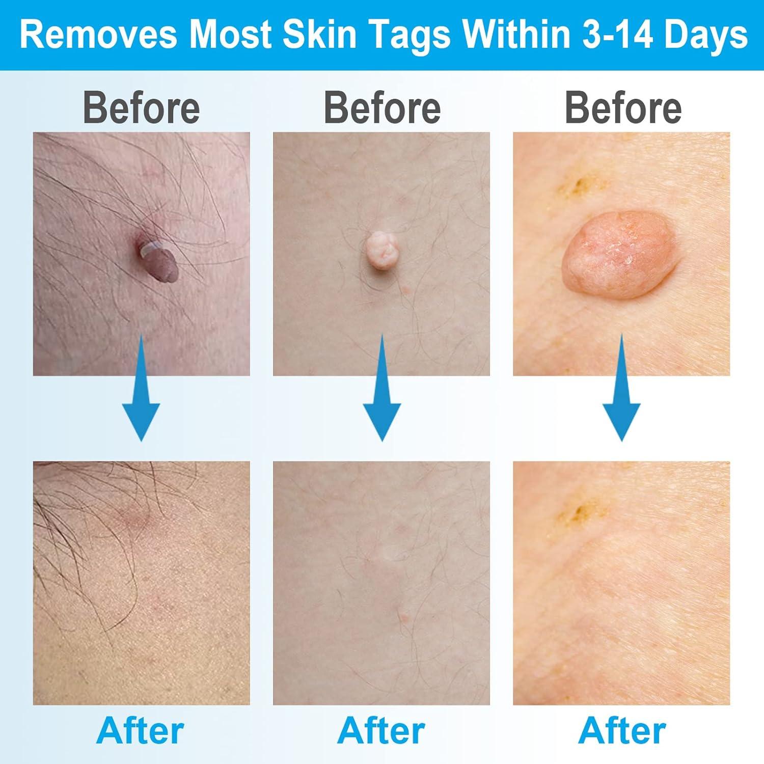 Painless 2-in-1 Skin Tag Removal Kit for Micro to Large Skin Tags (1 ...