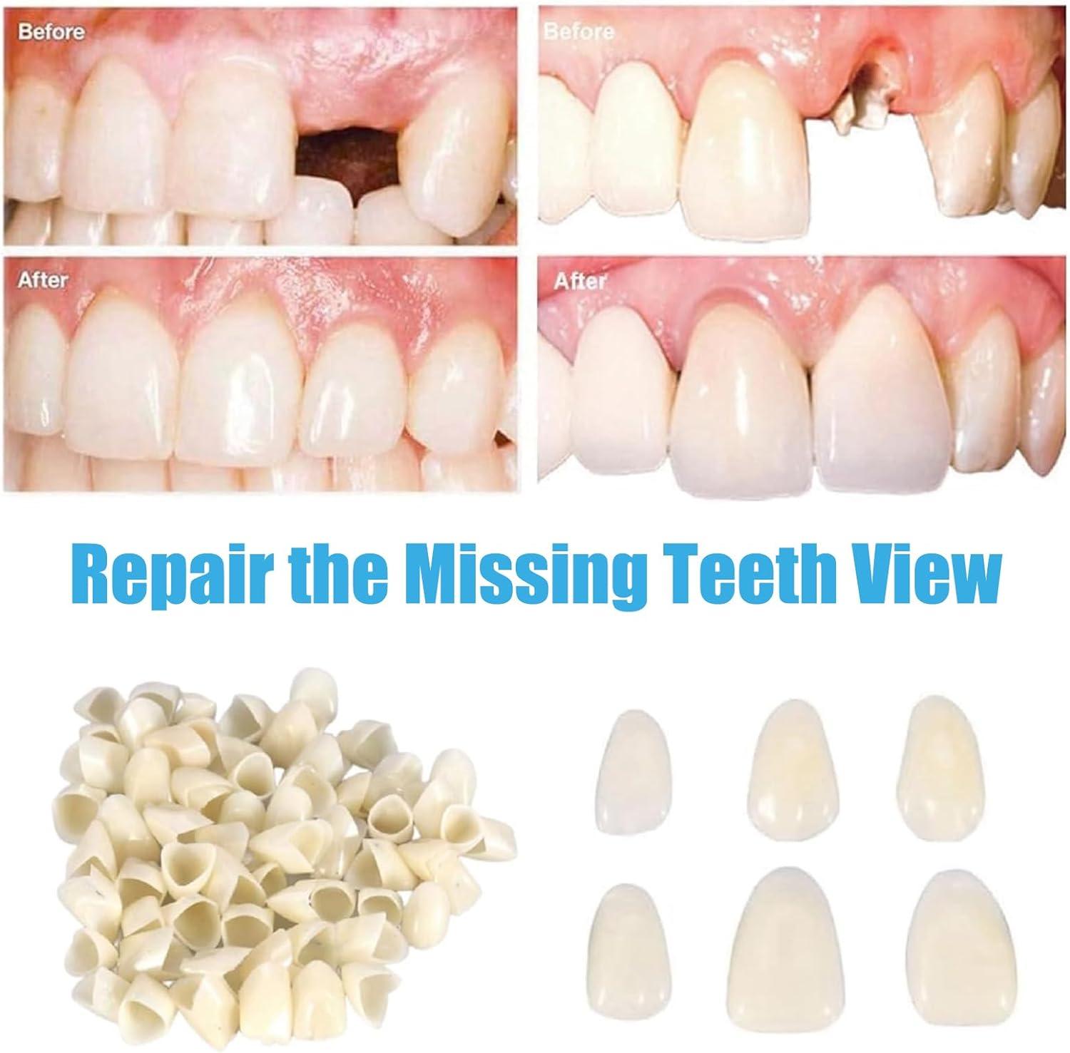 INBOLM 70PCS Temporary Tooth Crown Kit - Front Teeth Fake Tooth Repair ...