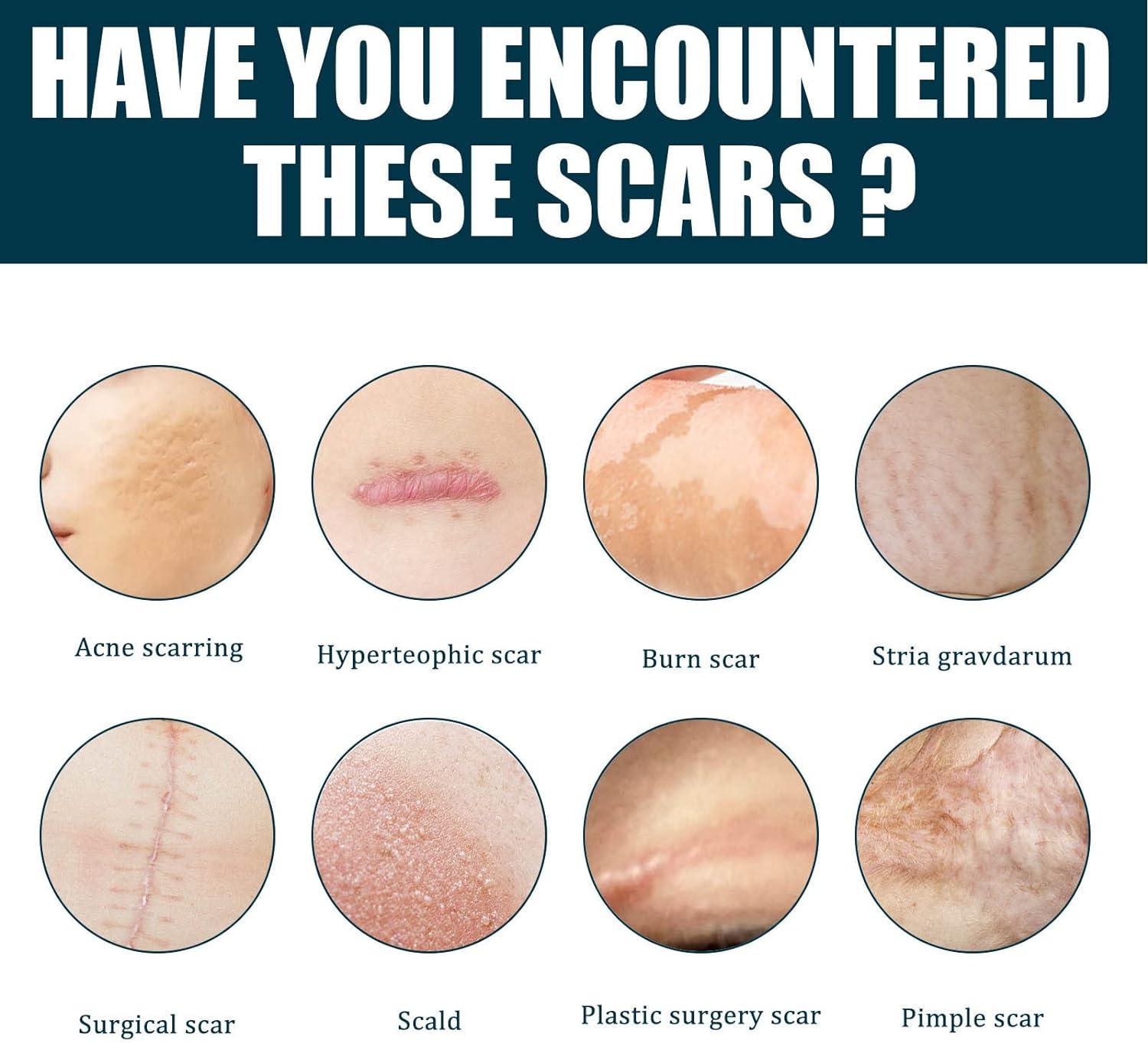 Scar Gel Cream for Surgery Injuries, Burns, Acne, & Cesarean Section ...