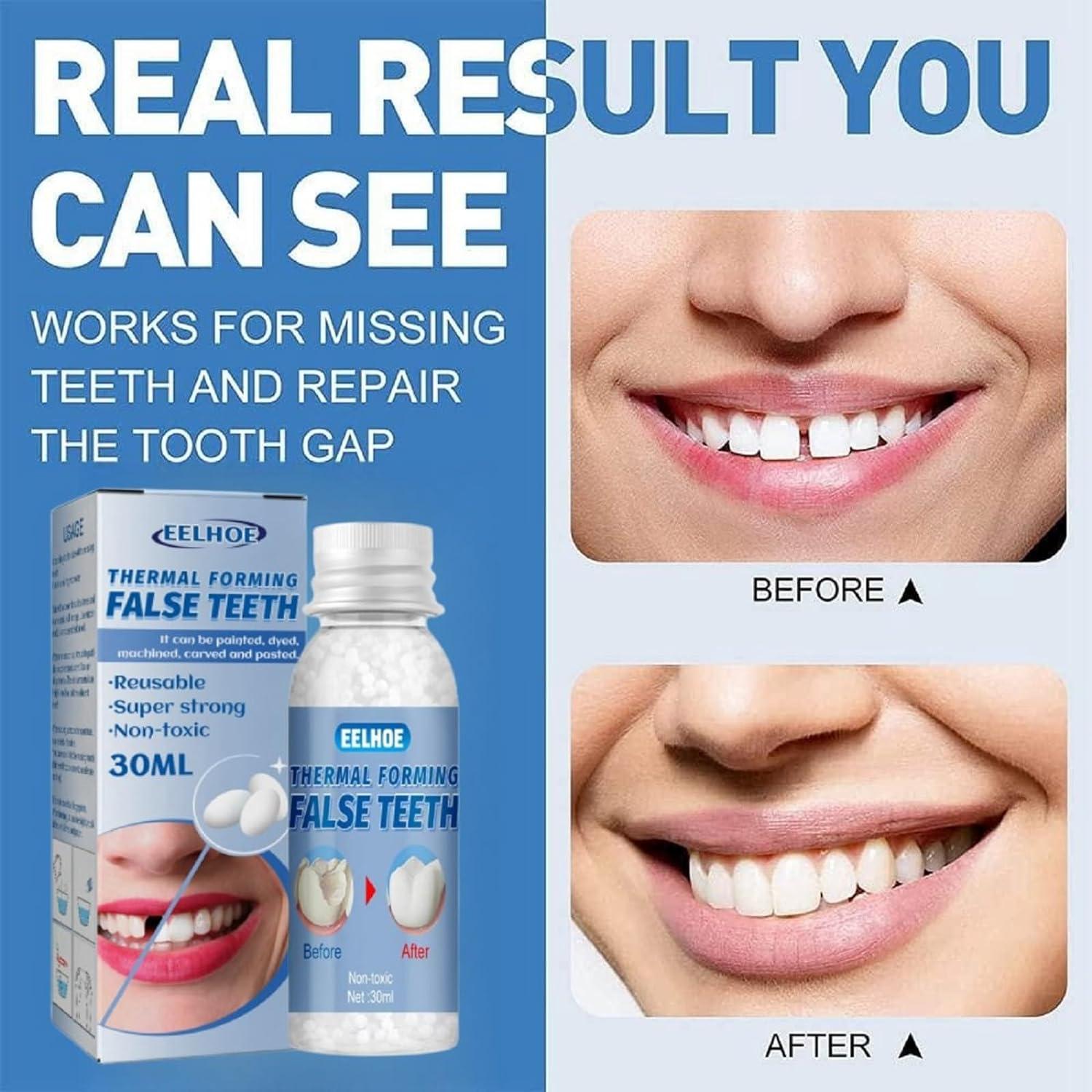 Temporary Tooth Filling Kit for Missing or Broken Tooth Repair ...