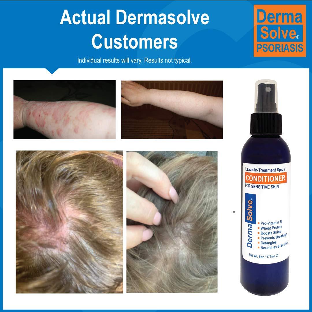 Dermasolve Psoriasis Leave-In Treatment Spray for Sensitive Skin - De ...