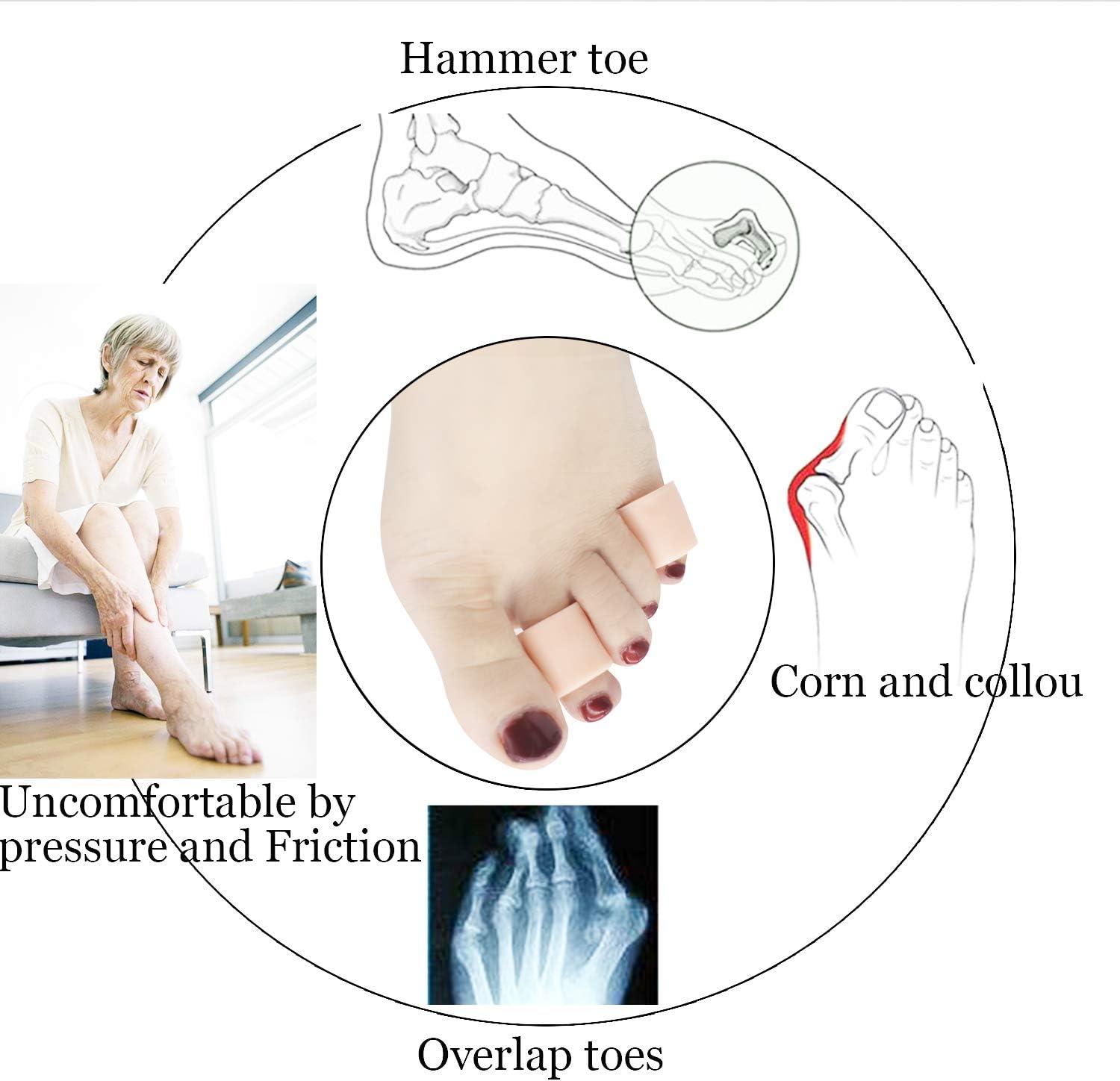 5 Pairs Gel Open Toe Sleeves | Toe Protectors for Hammer Toes Ingrown ...