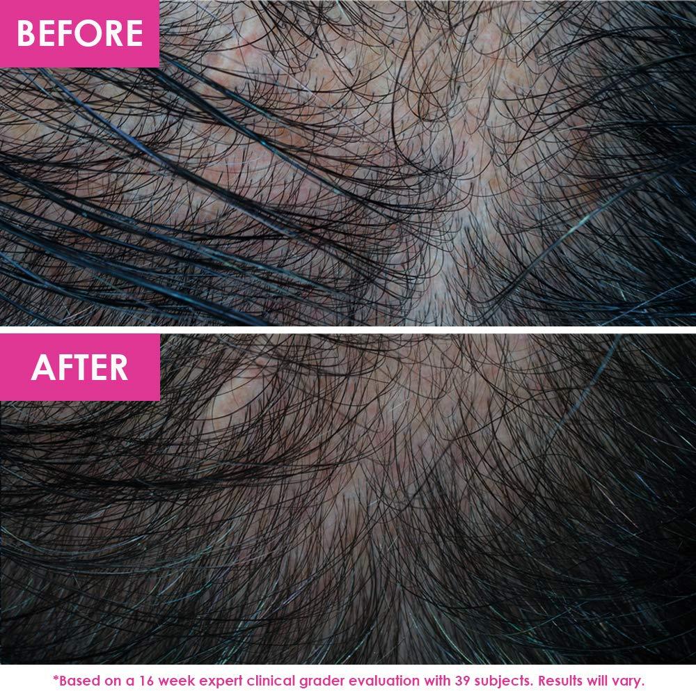 GrandeHAIR Hair Enhancing Serum - Promotes Thickness in Thinning Hair ...