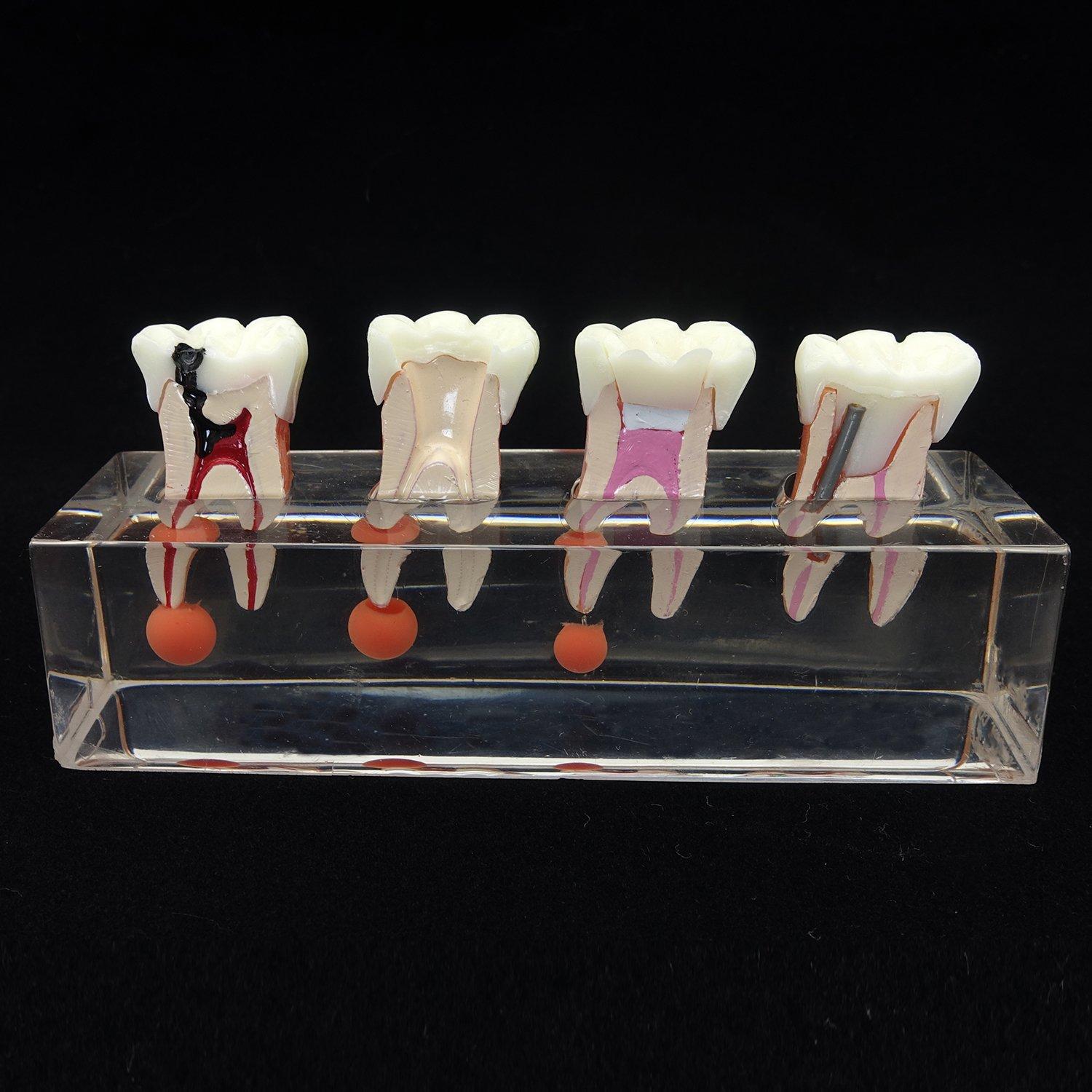 Dental Teeth Model for Endodontic Treatment - 4-Stage Teaching Aid for ...