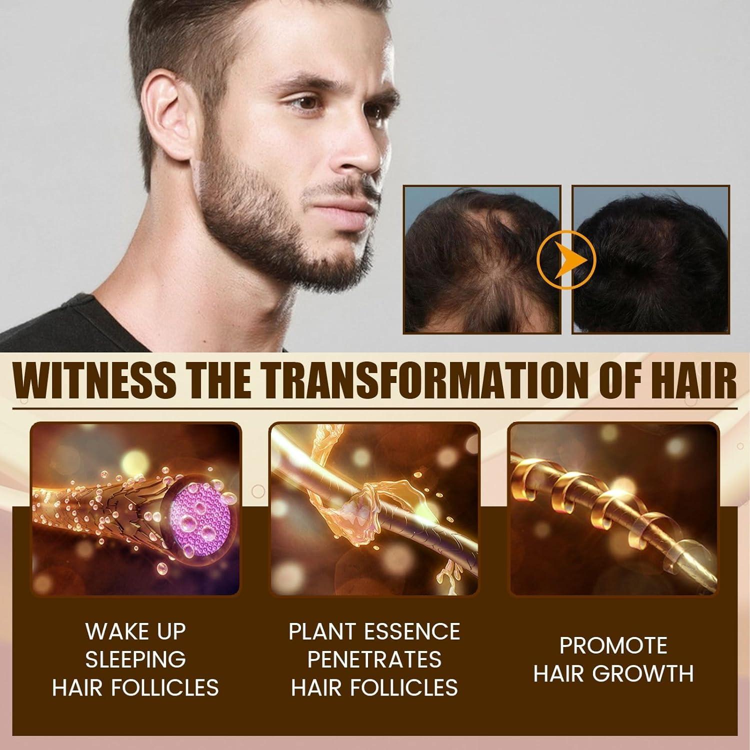 5% Biotin Minoxidil Hair Growth Oil 5% Minoxidil for Men and Women Hair ... 5% Biotin Minoxidil Hair Growth Oil 5% Minoxidil for Men and Women Hair ...