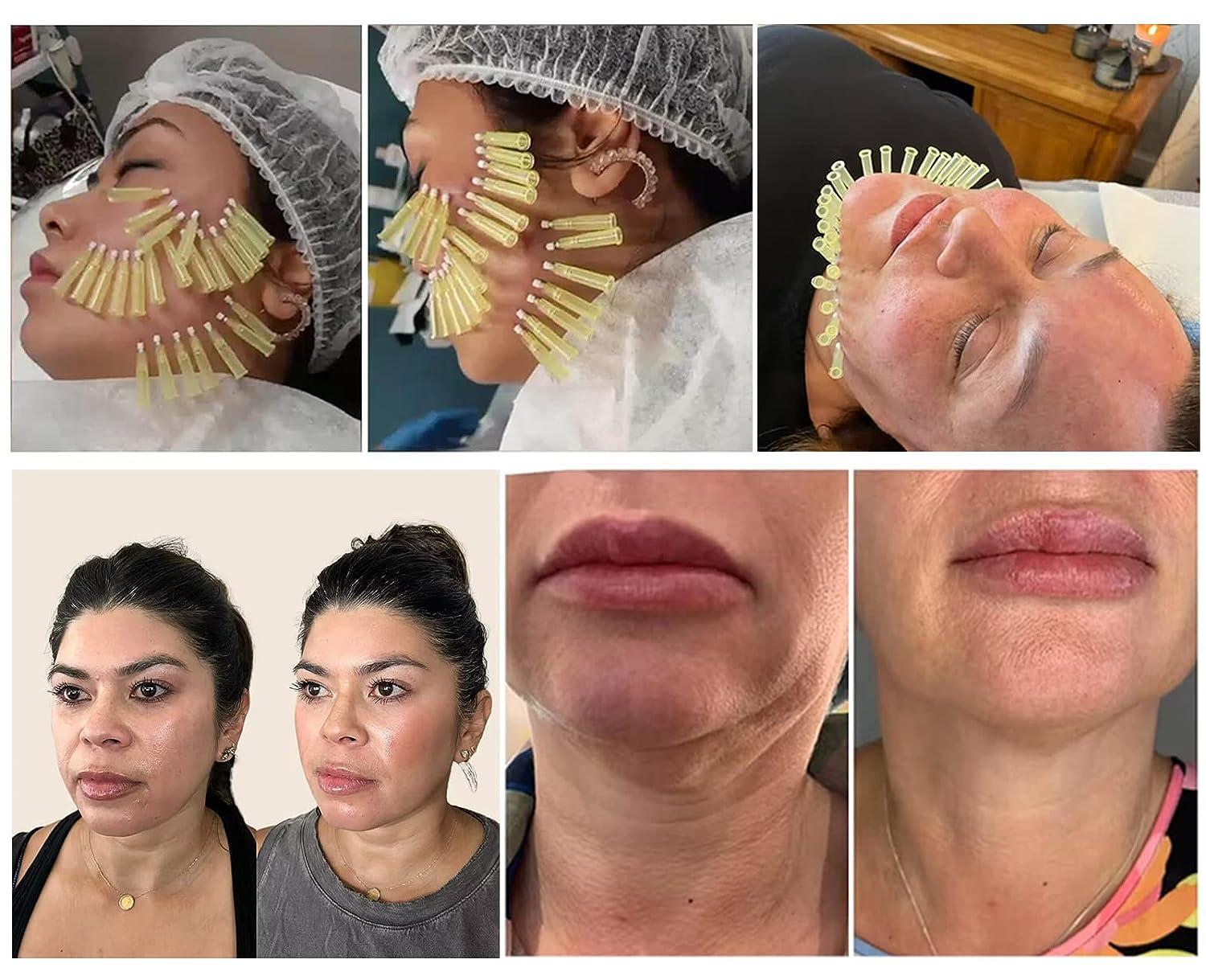 Acada PDO Thread Lift | Pdo Mono Smooth Threads 20pcs (30G25MM) | Buy ...