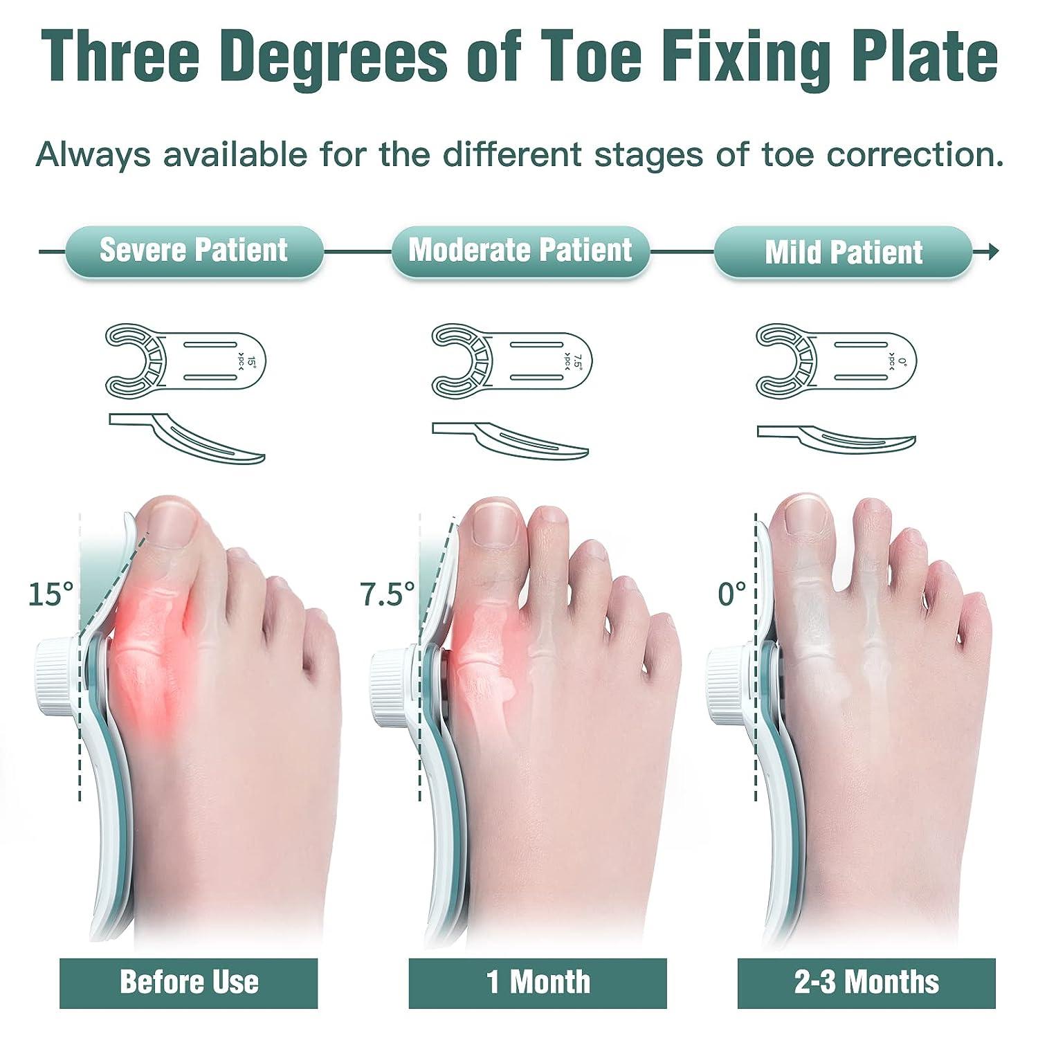 Bunion Corrector for Women & Men - Orthopedic Toe Straightener & Splint ...