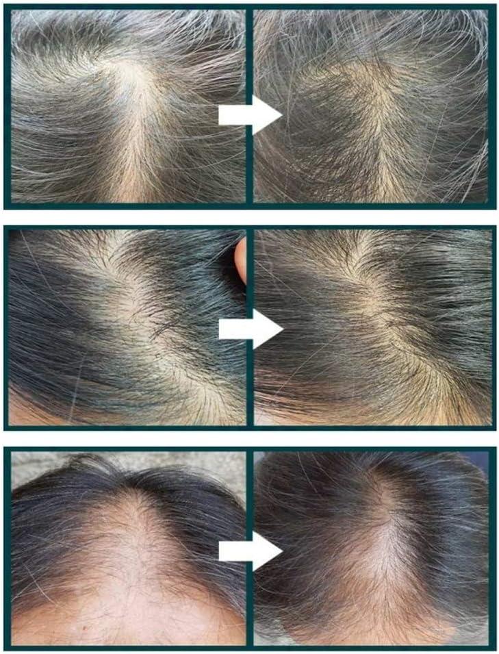 WHITESILK (100ml) THE SCM 85 (human stem cell) + HGF Therapy Anti-Hair ...