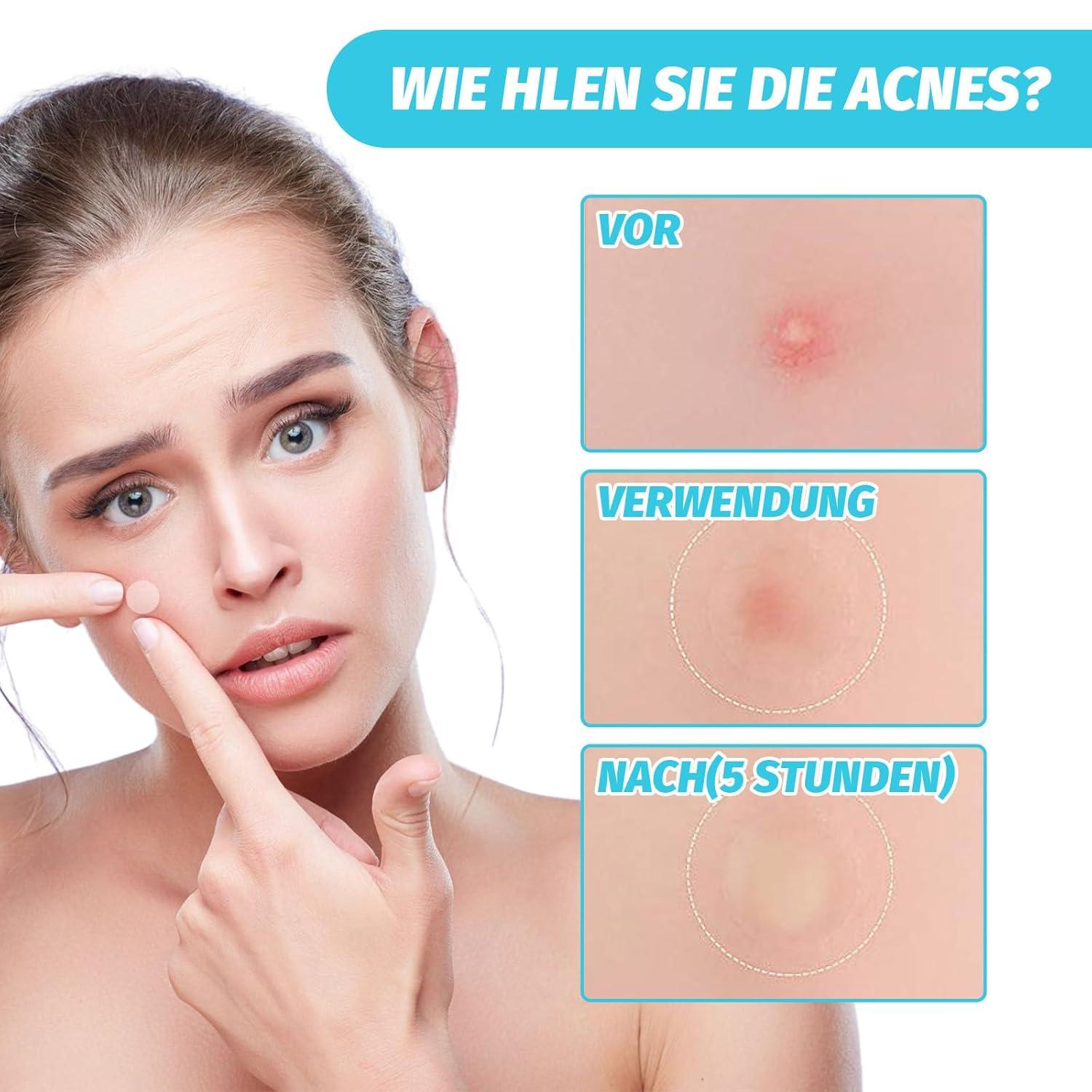 240 Pcs Invisible Hydrocolloid Pimple Patches - Waterproof Acne ...