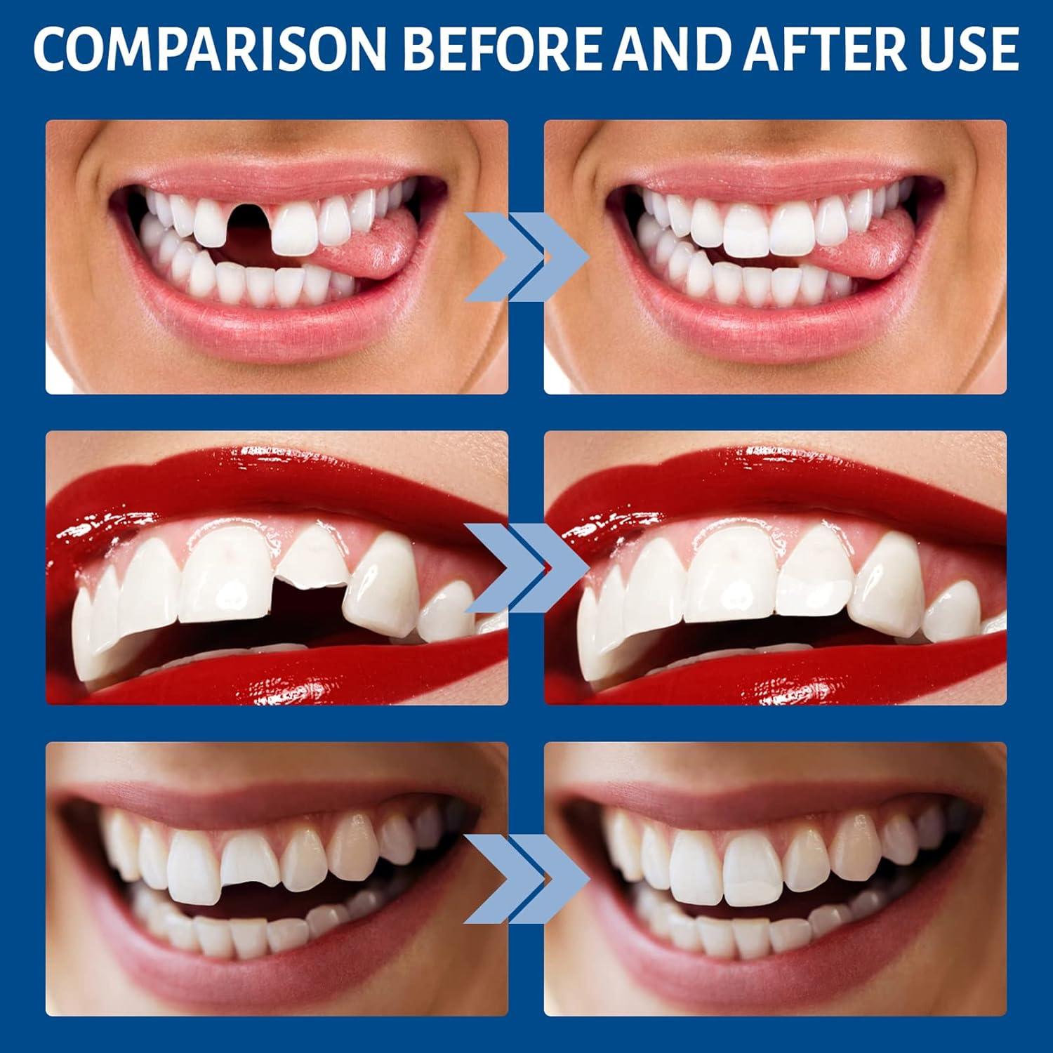 Provisional Denture Adhesive Set | Temporary Dental Repair Kit ...