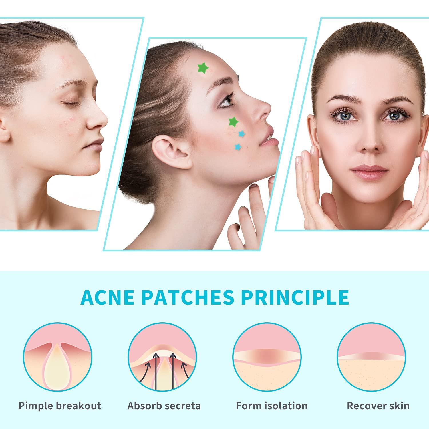 Star-Shaped Pimple Patch with Tea Tree Oil & Salicylic Acid - 108 Dots ...