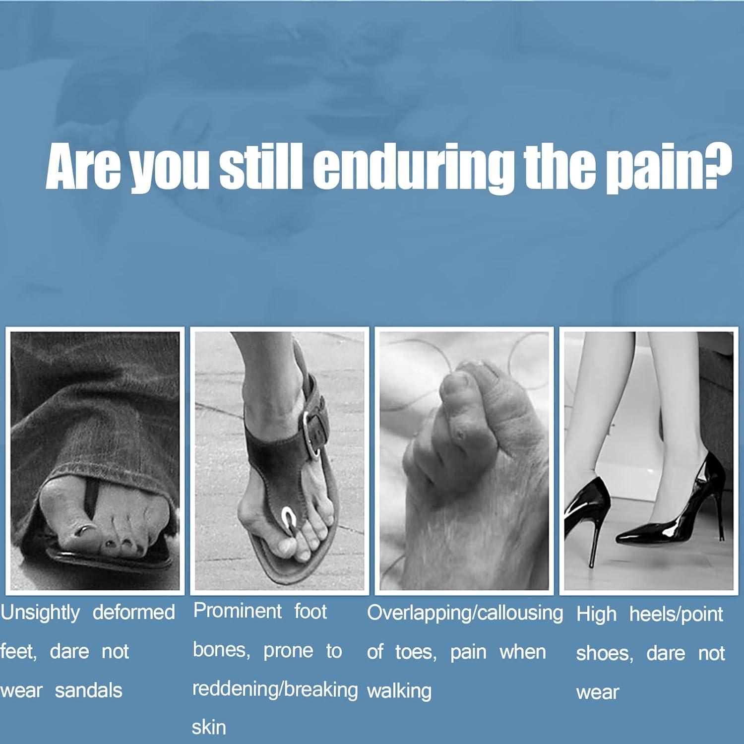 SULOY Thumb Valgus Corrector - Adjustable Orthopedic Bunion Relief for ...