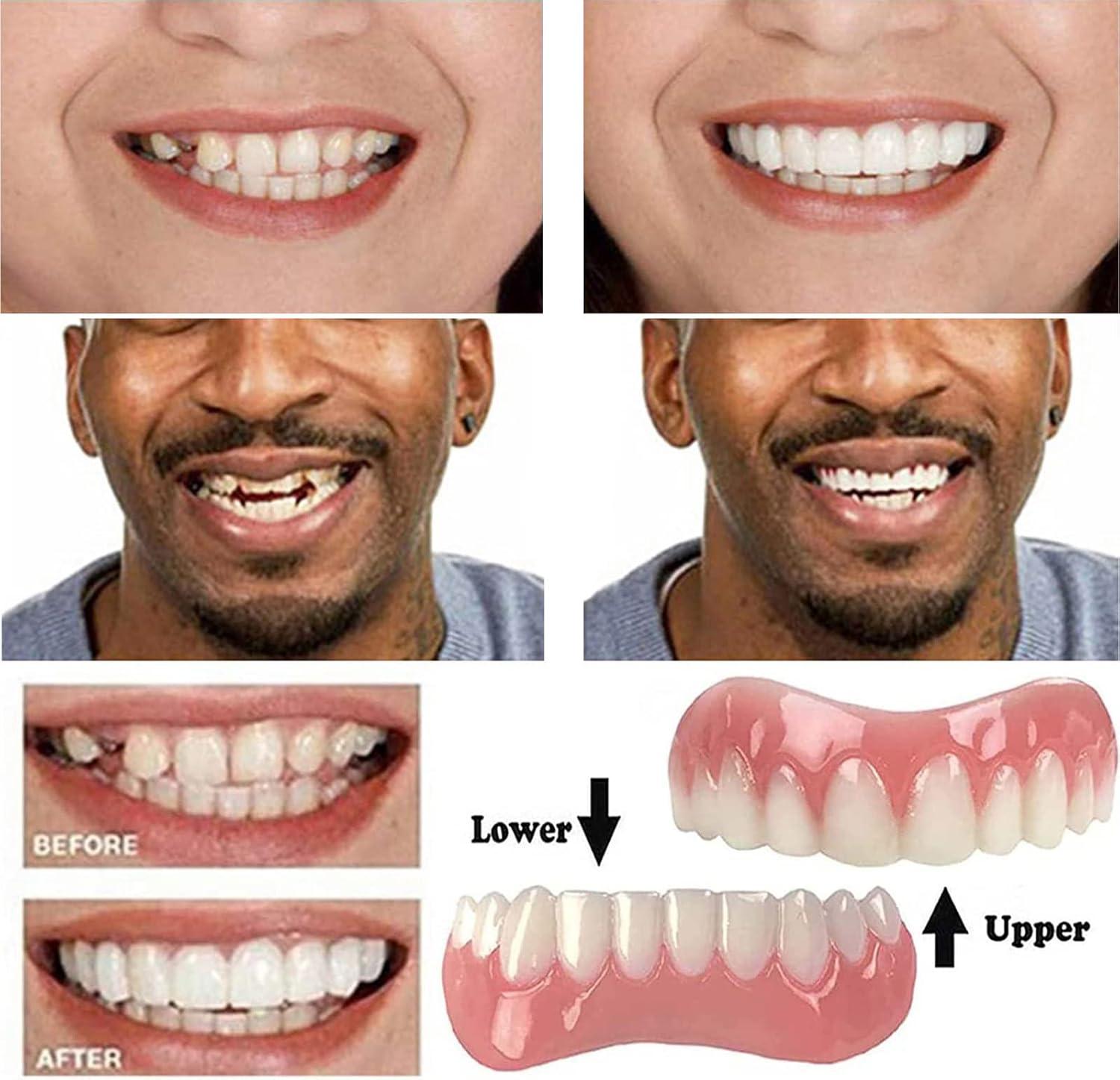 High-Quality Silicone Artificial Teeth & Veneers | Perfect Laugh ...