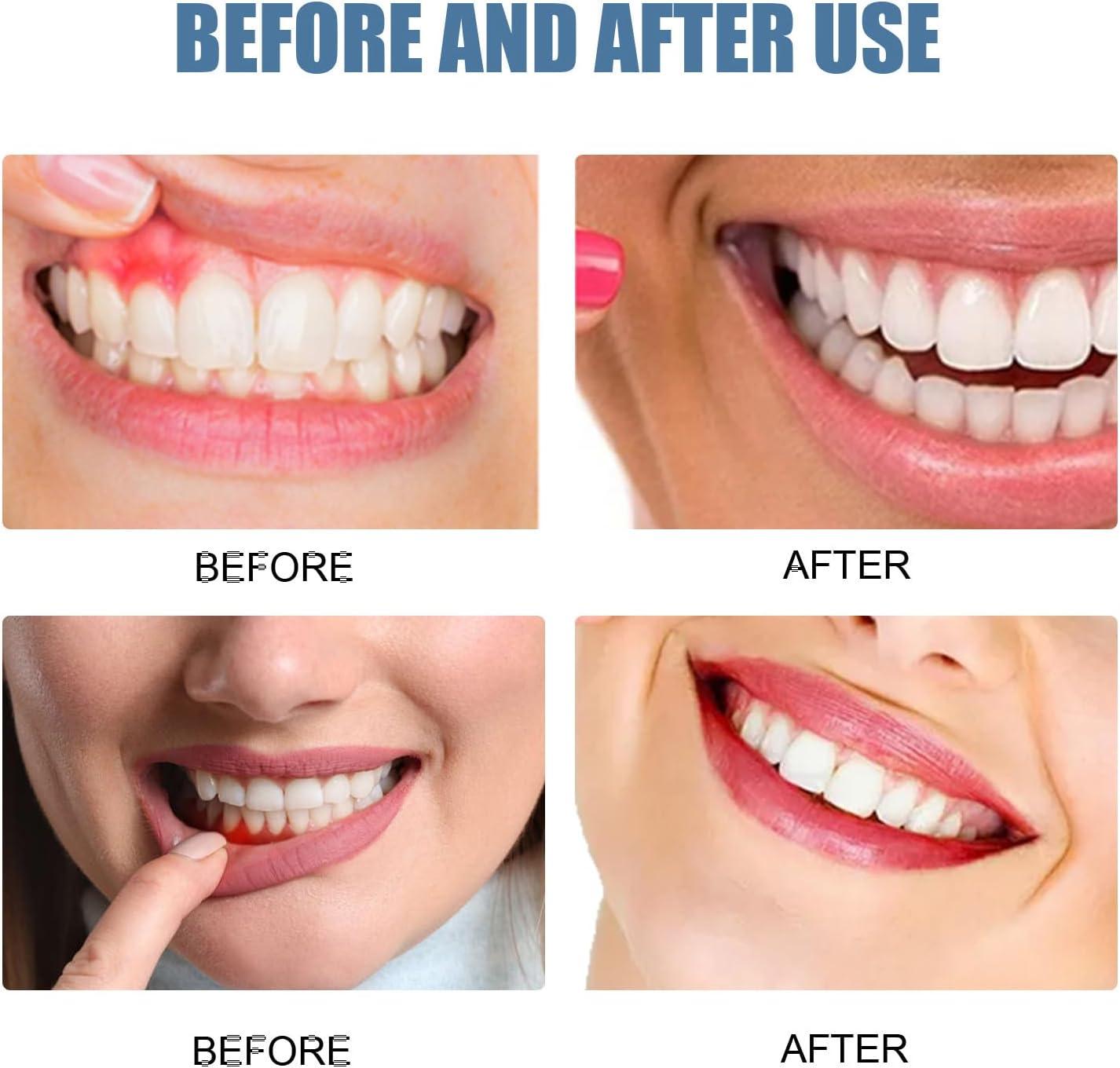 Koahde Tooth & Gum Care Spray - Toothache Relief Gum Repair & Regrowth ...