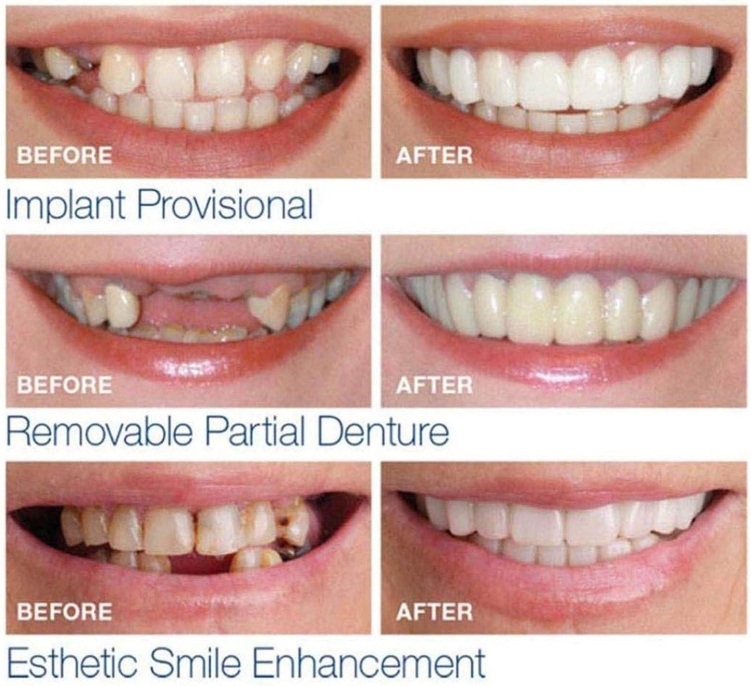 4-Piece Cosmetic Tooth Veneers - Instant Smile Makeover & Teeth ...