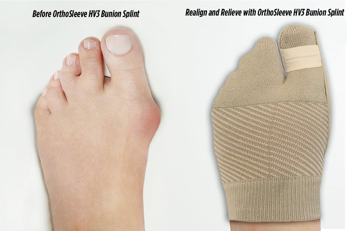 OrthoSleeve HV3 Bunion Brace/Splint (One Sleeve) for Foot Bunion Pain ...