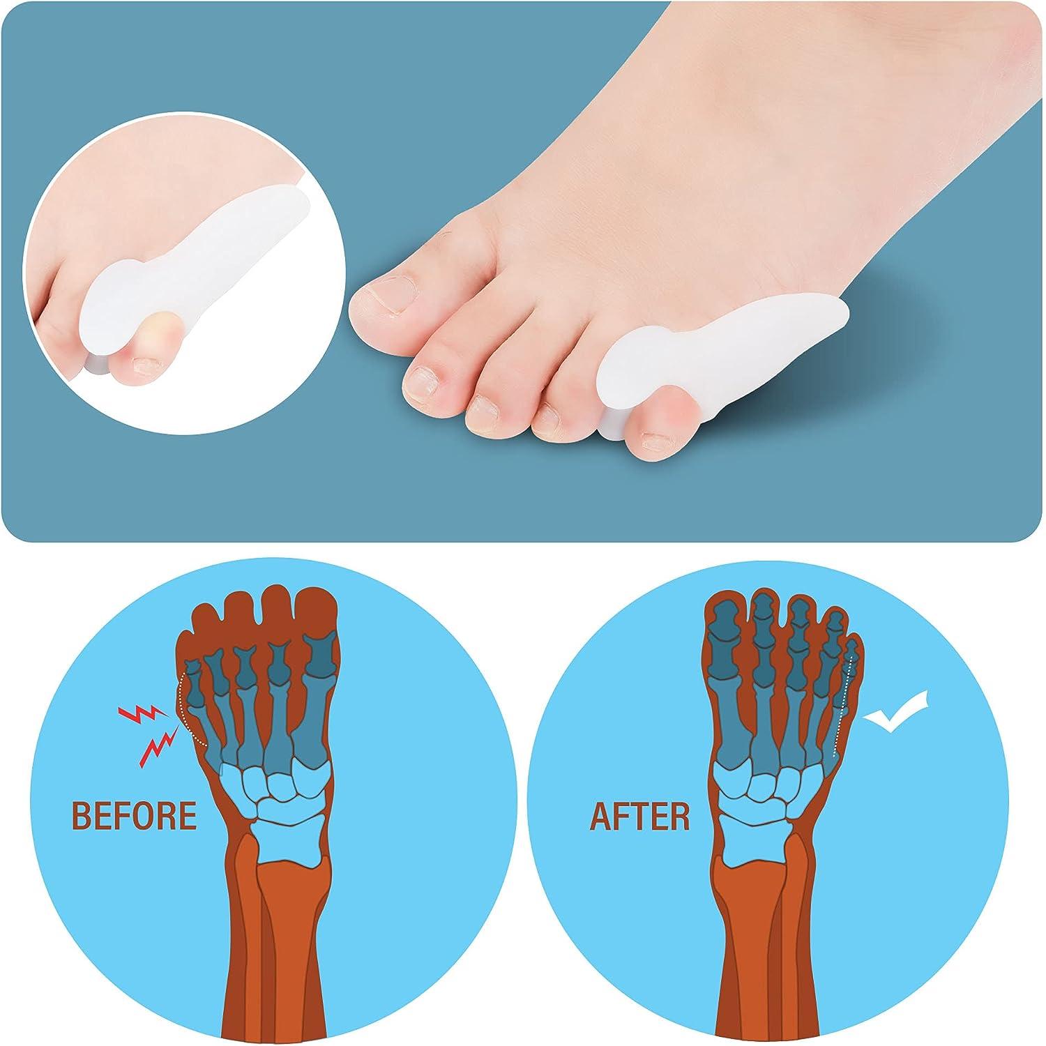 Pinky Toe Separator Gel Bunionette Protector - 6 PCS Tailors Bunion ...