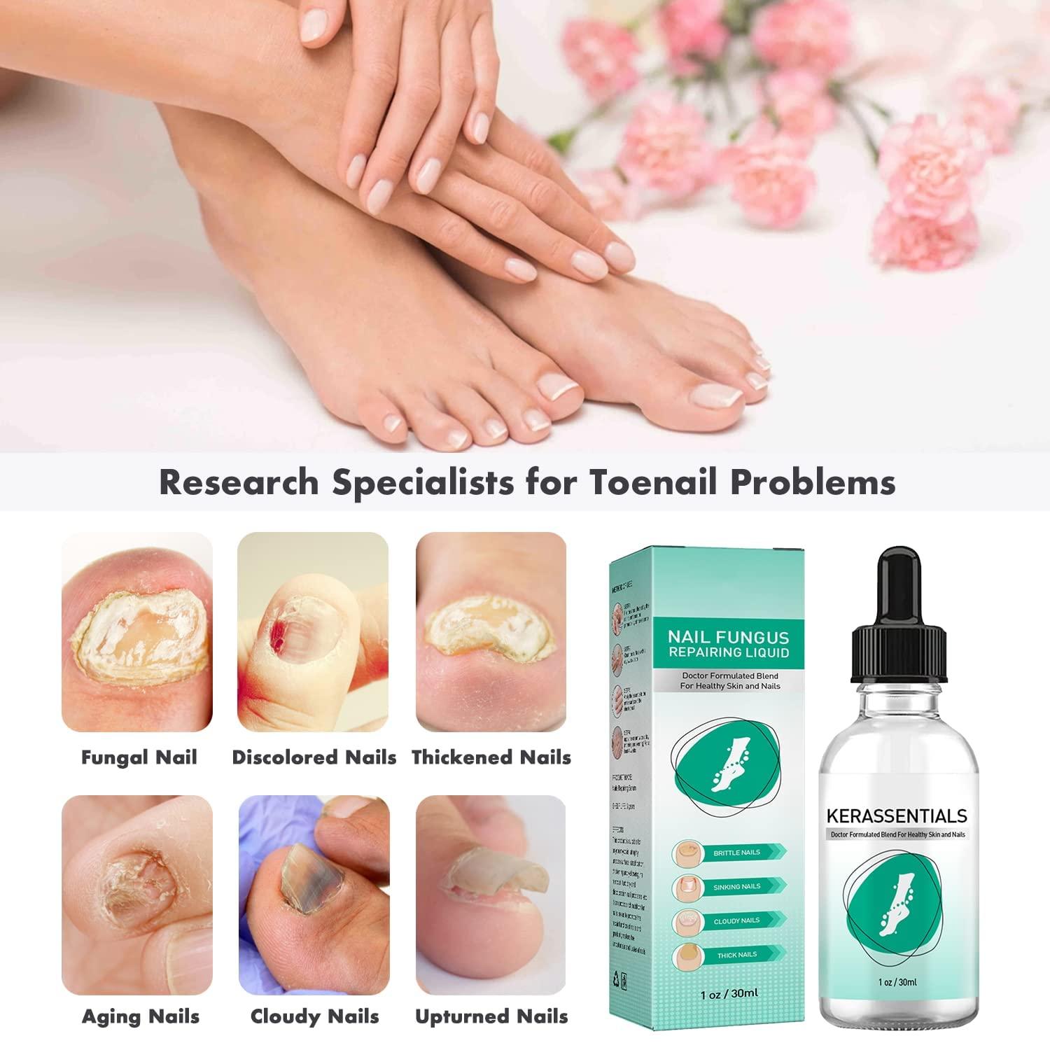 Kerassentials Toenail Treatment Extra Strength - 3 Pcs for Nail Repair