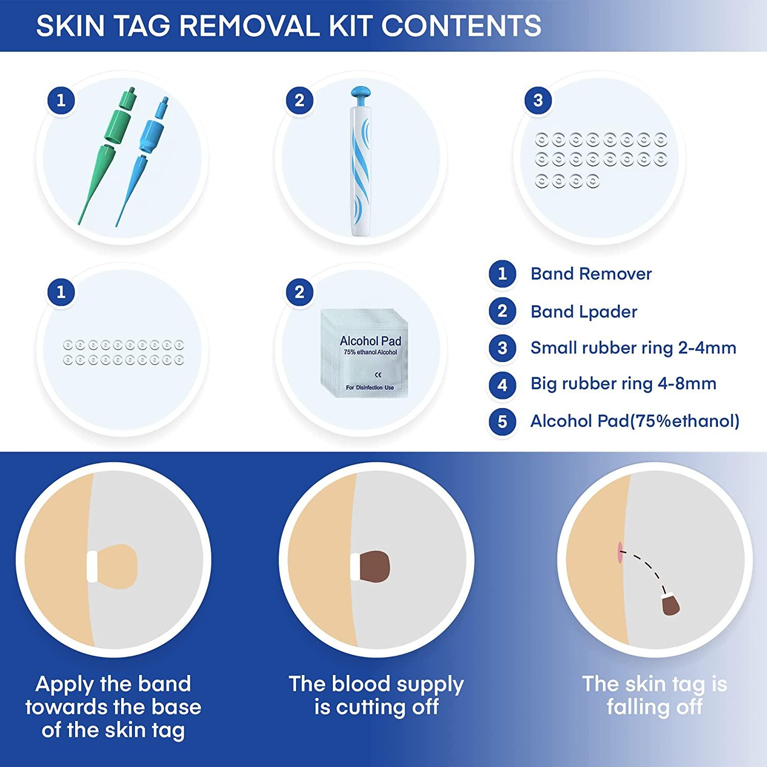 Natural Skin Tag Remover Device Kit for 2-8mm Tags | Easy, Safe ...