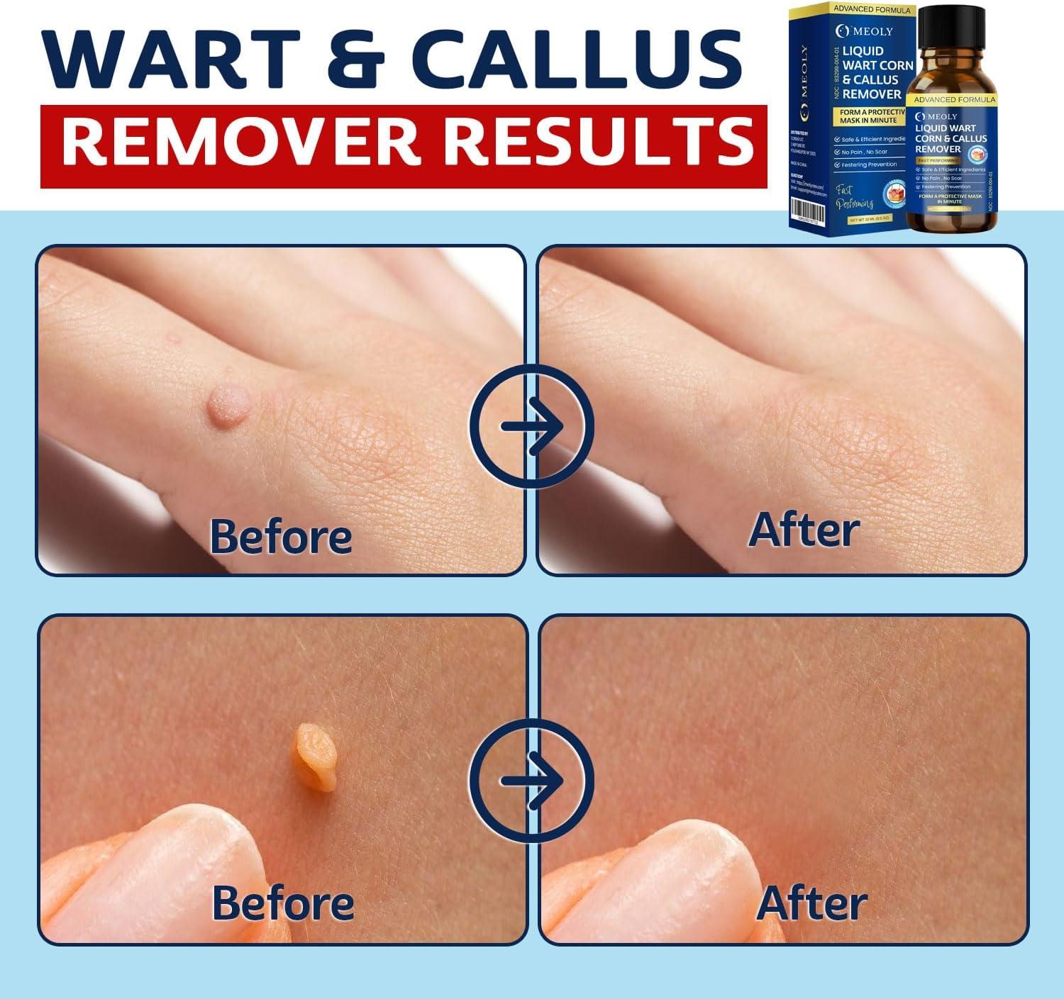 Fast-Acting Wart Remover - Salicylic Acid Treatment for All Warts Corns ...