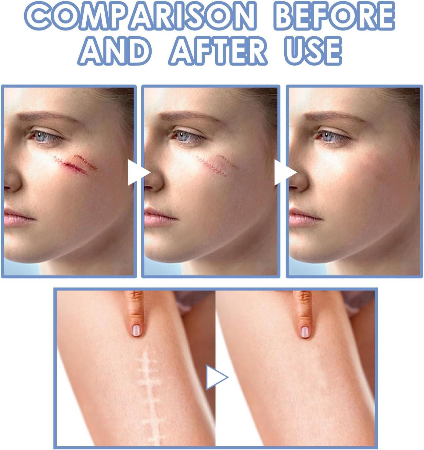 Advanced Scar Removal Serum - Medical Grade Spray for All Types of ...