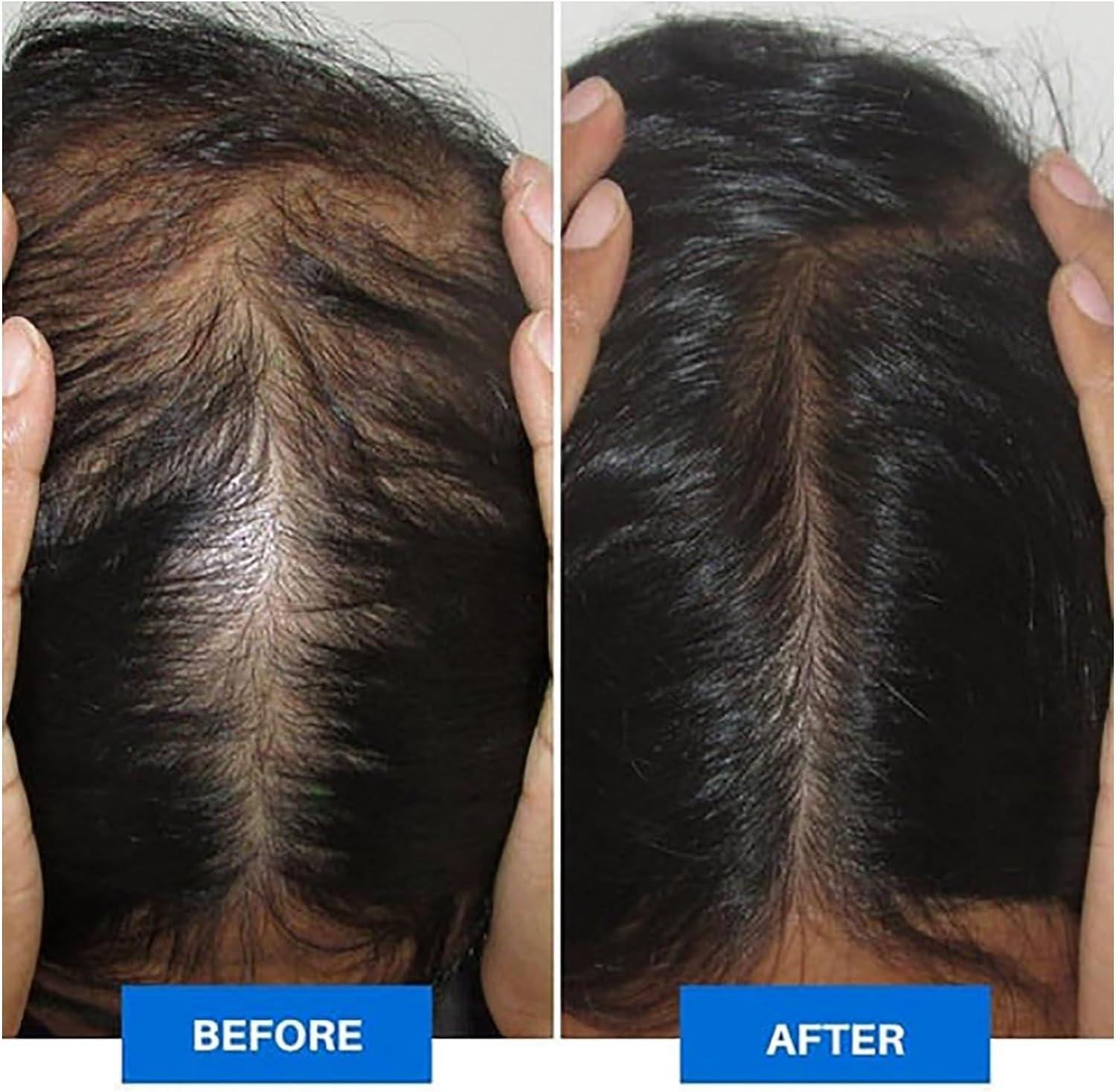 Scalphero - Smart Scalp Massager for Hair Growth | Portable Waterproof ...