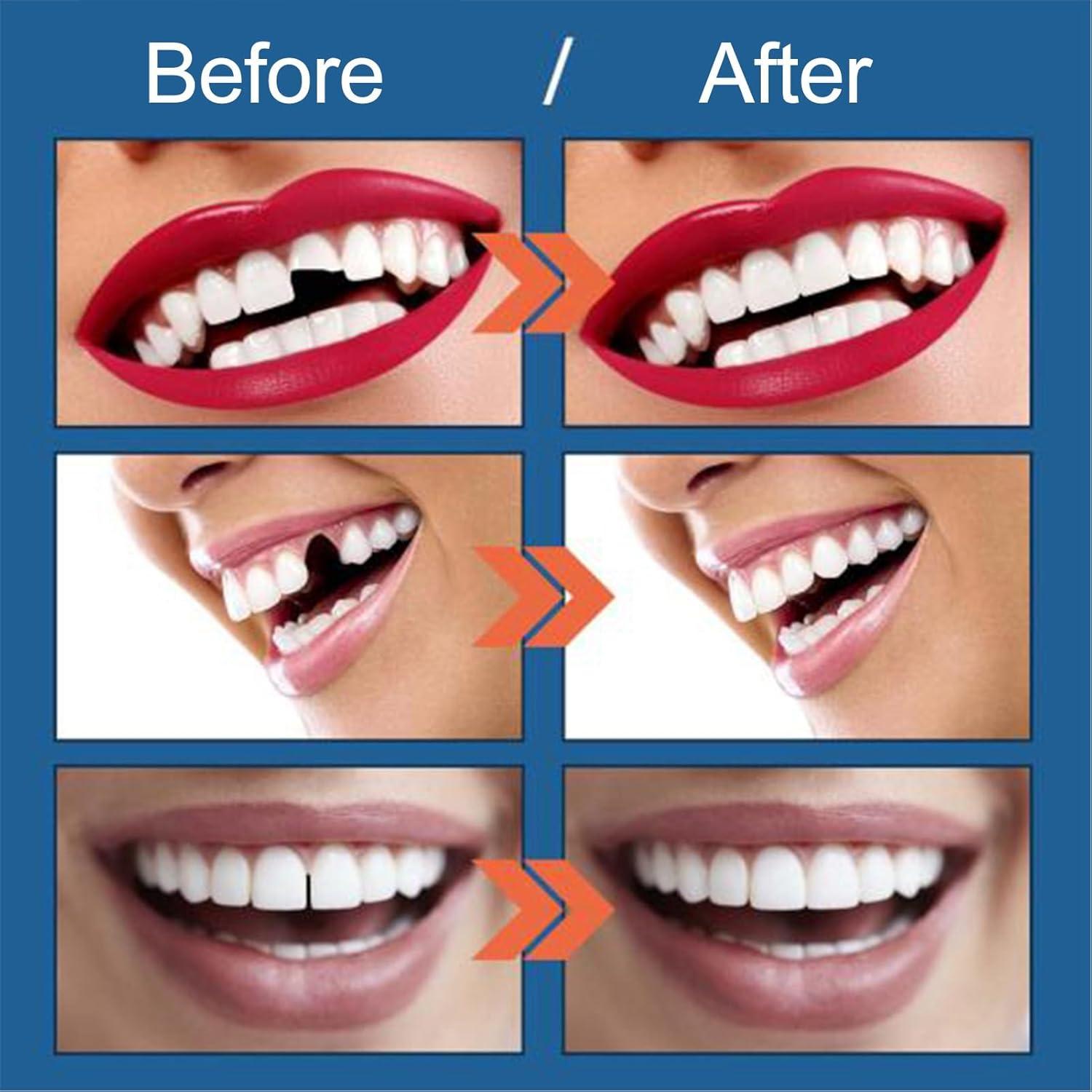 Horoper Temporary Tooth Repair Set | Formable Artificial Teeth for ...