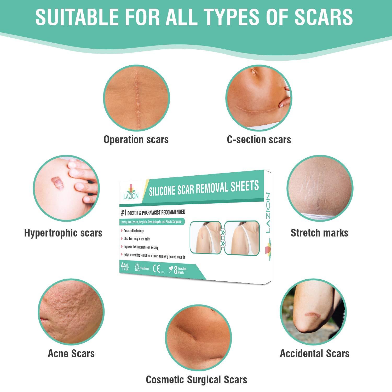 Silicone Scar Removal Sheets - Reusable & Washable for Surgery, Stretch ...