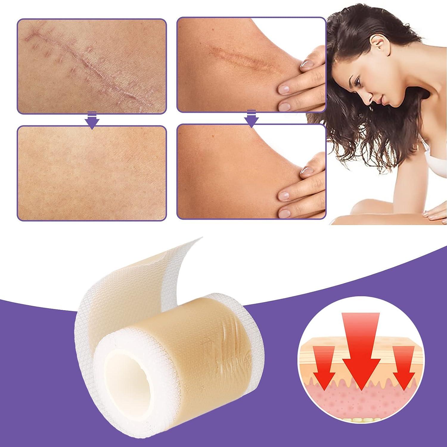 Breathable Reusable Silicone Scar Sheet Roll - Soften Old & New Scars ...