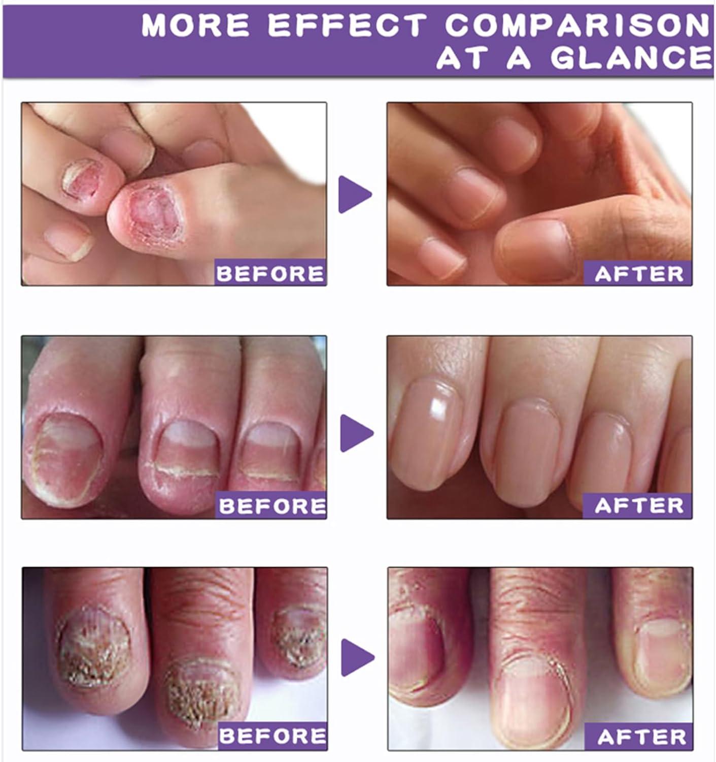 Nail Fungal Treatment Spray - Advanced Toenail & Nail Strengthener ...