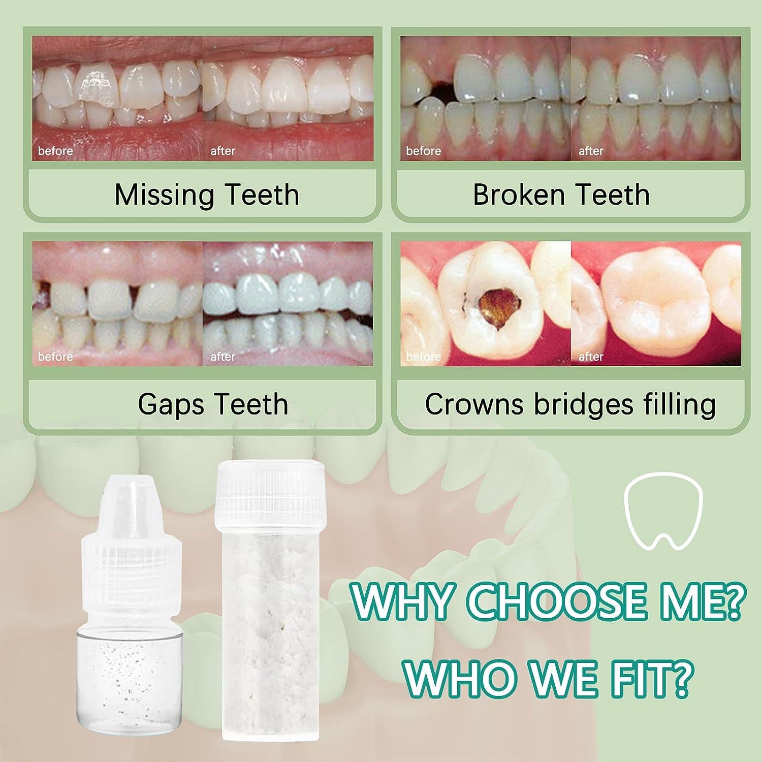 Teeth Repair Kit - Fill Missing/Broken Tooth, Close Gaps, Quick & Safe ...