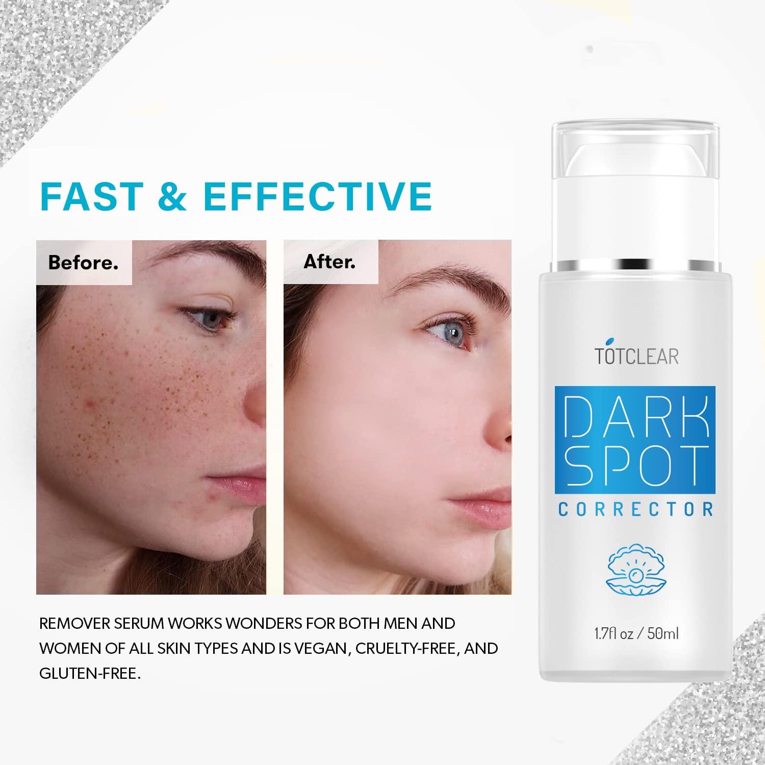 TOTCLEAR Dark Spot Remover For face and Body Updated Dark Spot ...