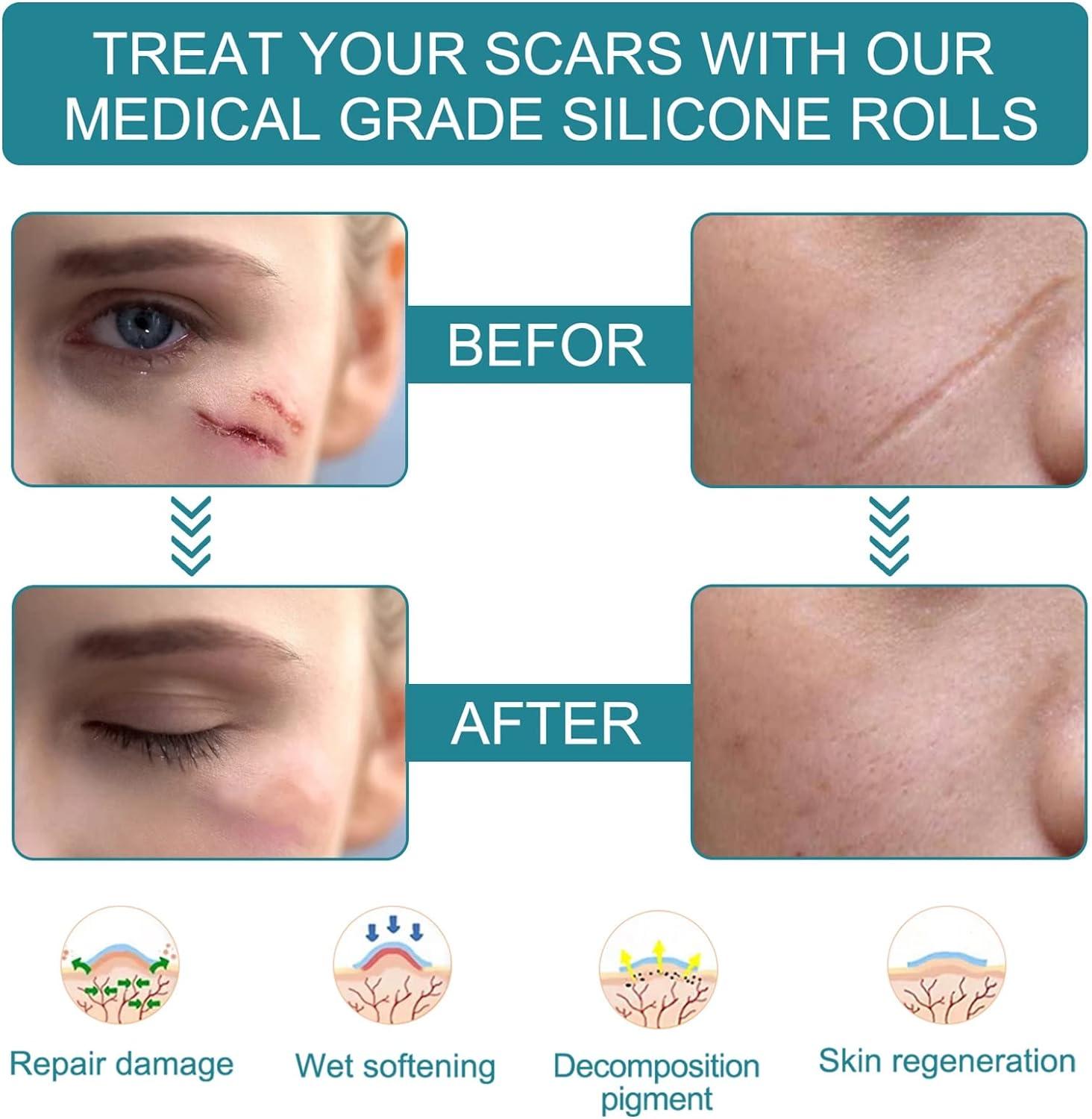 Silicone Gel Scar Removal Patch - Reusable Strip for Trauma, Burn, and ...