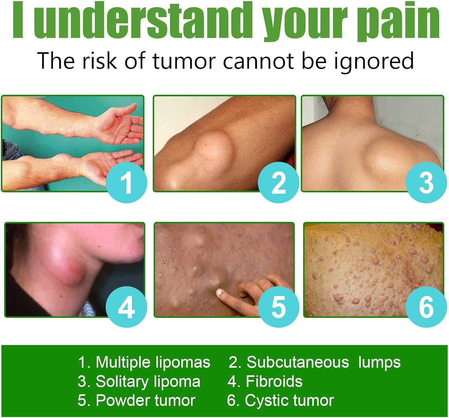 Delipidation Cream for Lipoma Removal and Anti-Swelling - Cellulite ...