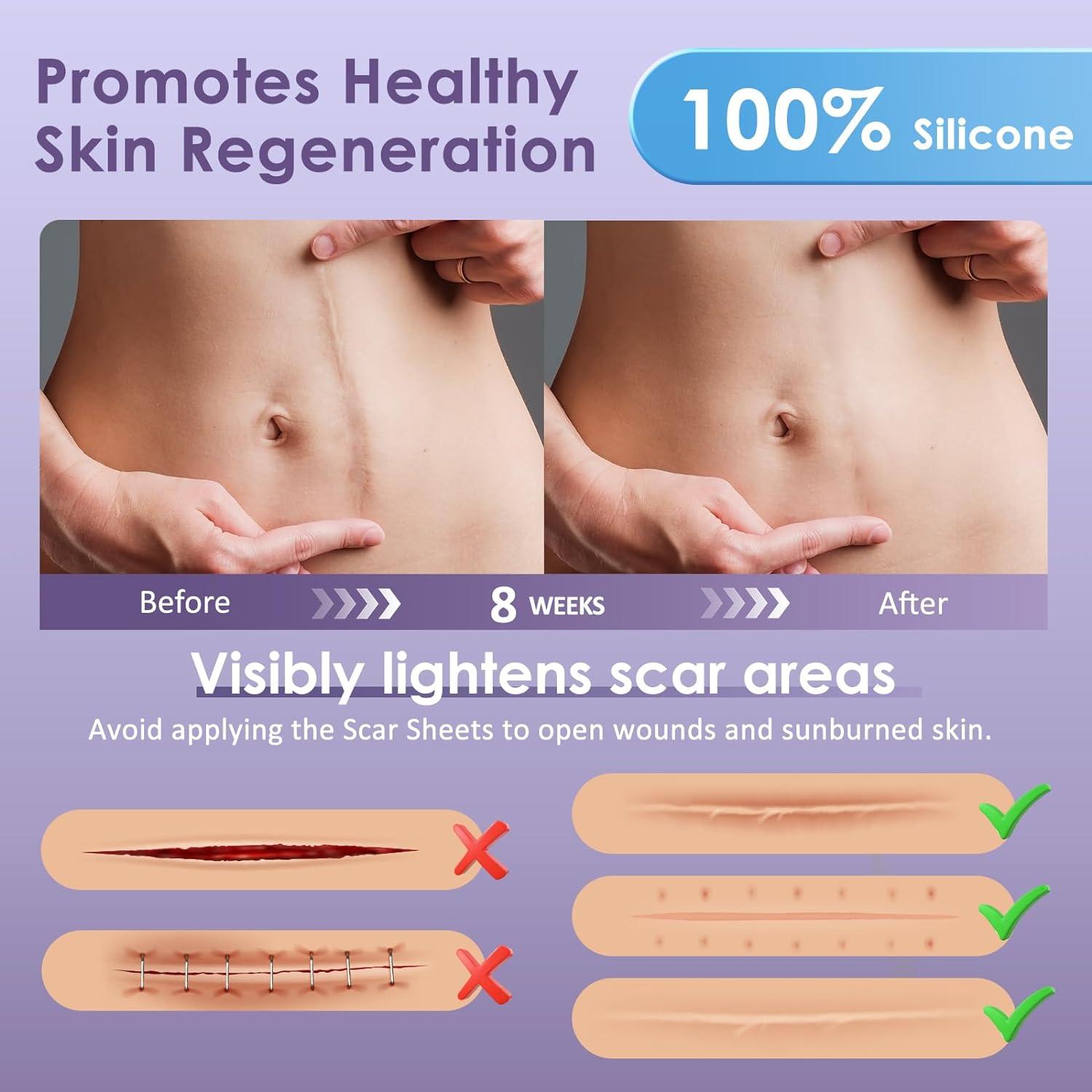 keloid scar c section